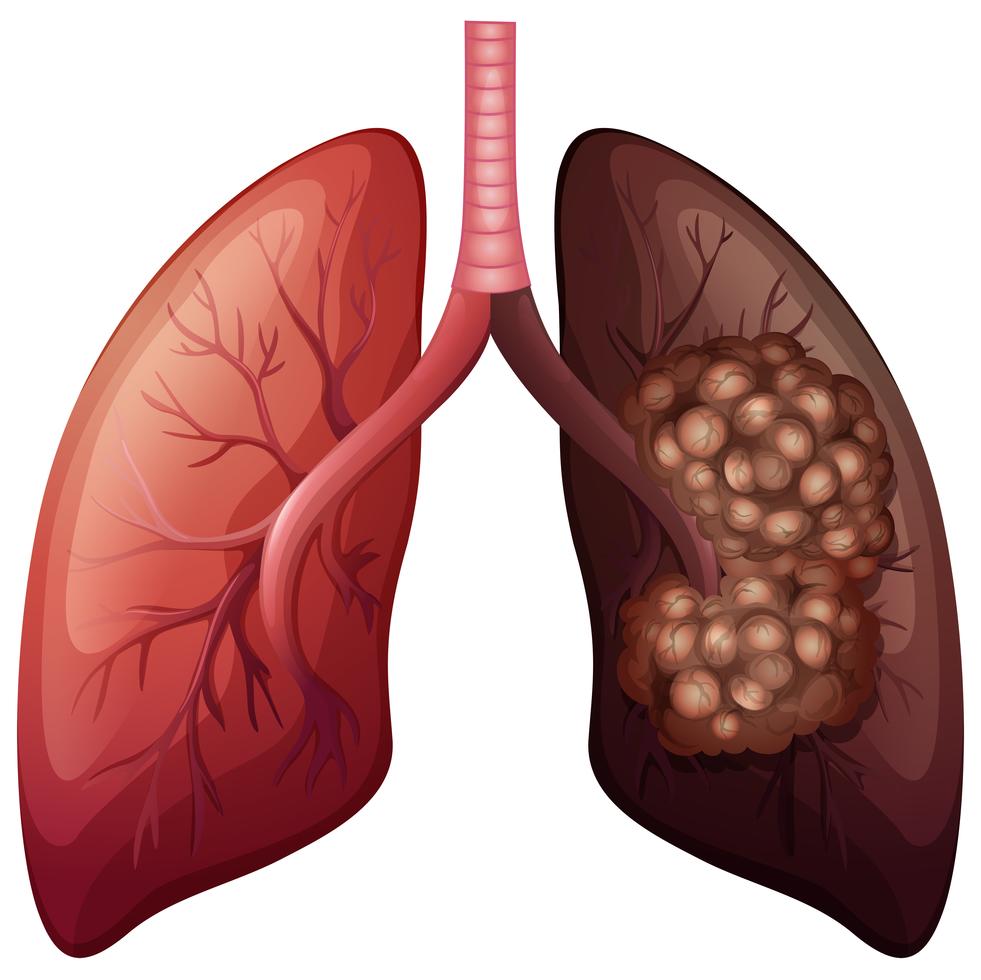 Normal Lung And Lung Cancer 295185 Vector Art At Vecteezy normal-lung-and-lung-cancer-295185-vector-art-at-vecteezy