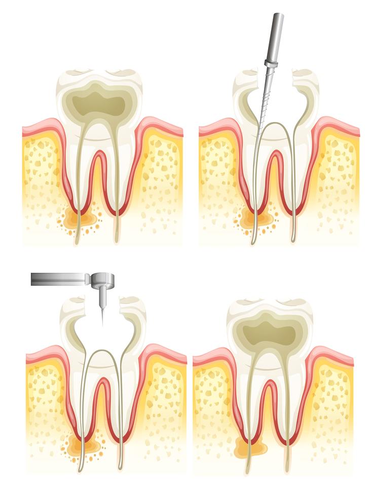 Root canal process 430611 Vector Art at Vecteezy