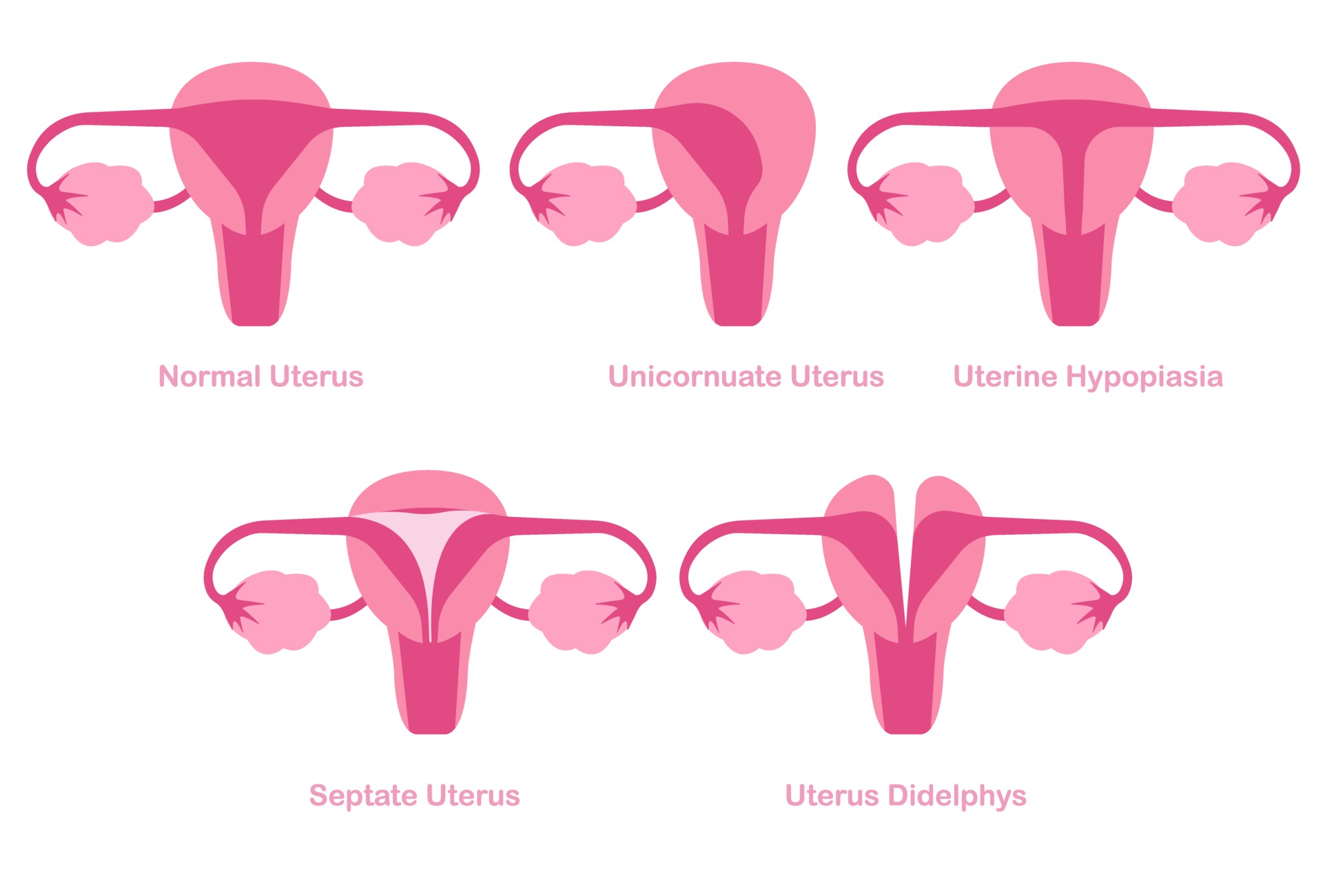 Congenital Mullerian Anomalies Or Uterine Abnormalities Concept