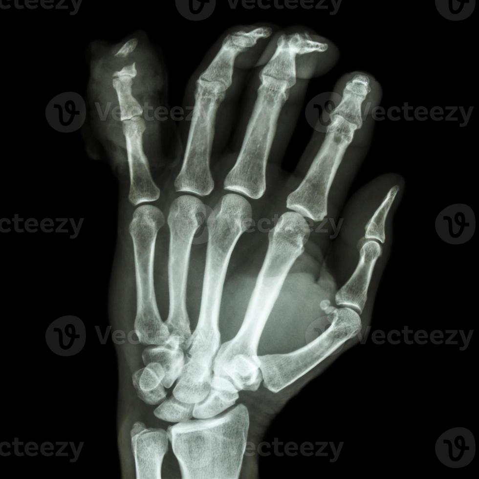 película radiografía mano mostrar fractura distal pharange meñique ... película radiografía mano mostrar fractura distal pharange meñique ...