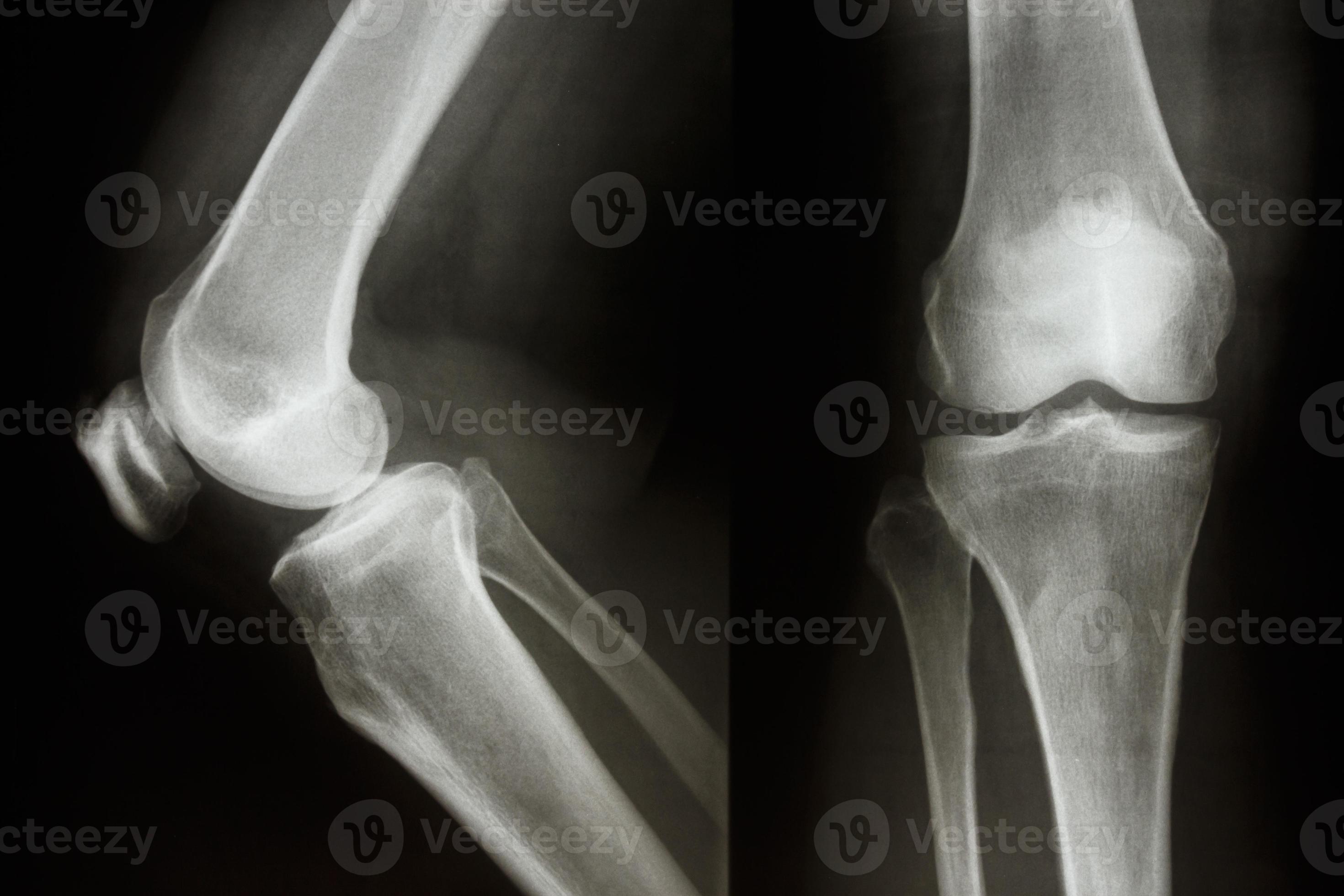 Película de rayos x muestran articulación de rodilla normal ap lateral ... Película de rayos x muestran articulación de rodilla normal ap lateral ...