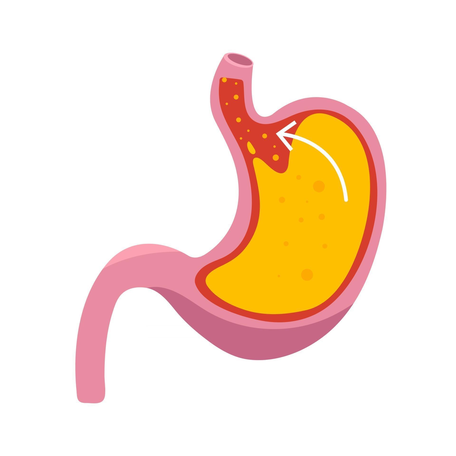 Enfermedad Por Reflujo Gastroesofágico O Gerd 2557093 Vector En Vecteezy