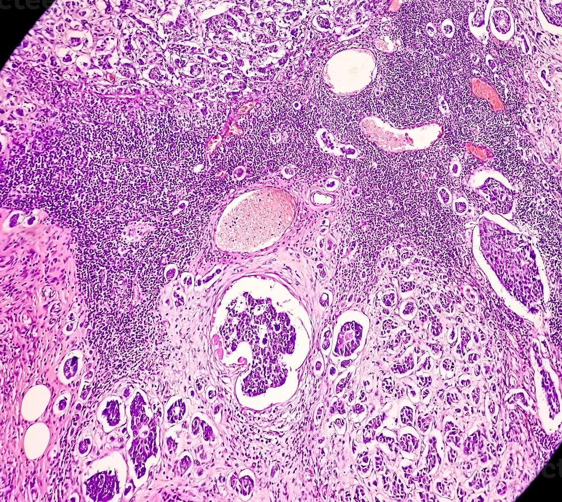 Low power photomicrograph of a breast core biopsy showing an invasive ... Low power photomicrograph of a breast core biopsy showing an invasive ...