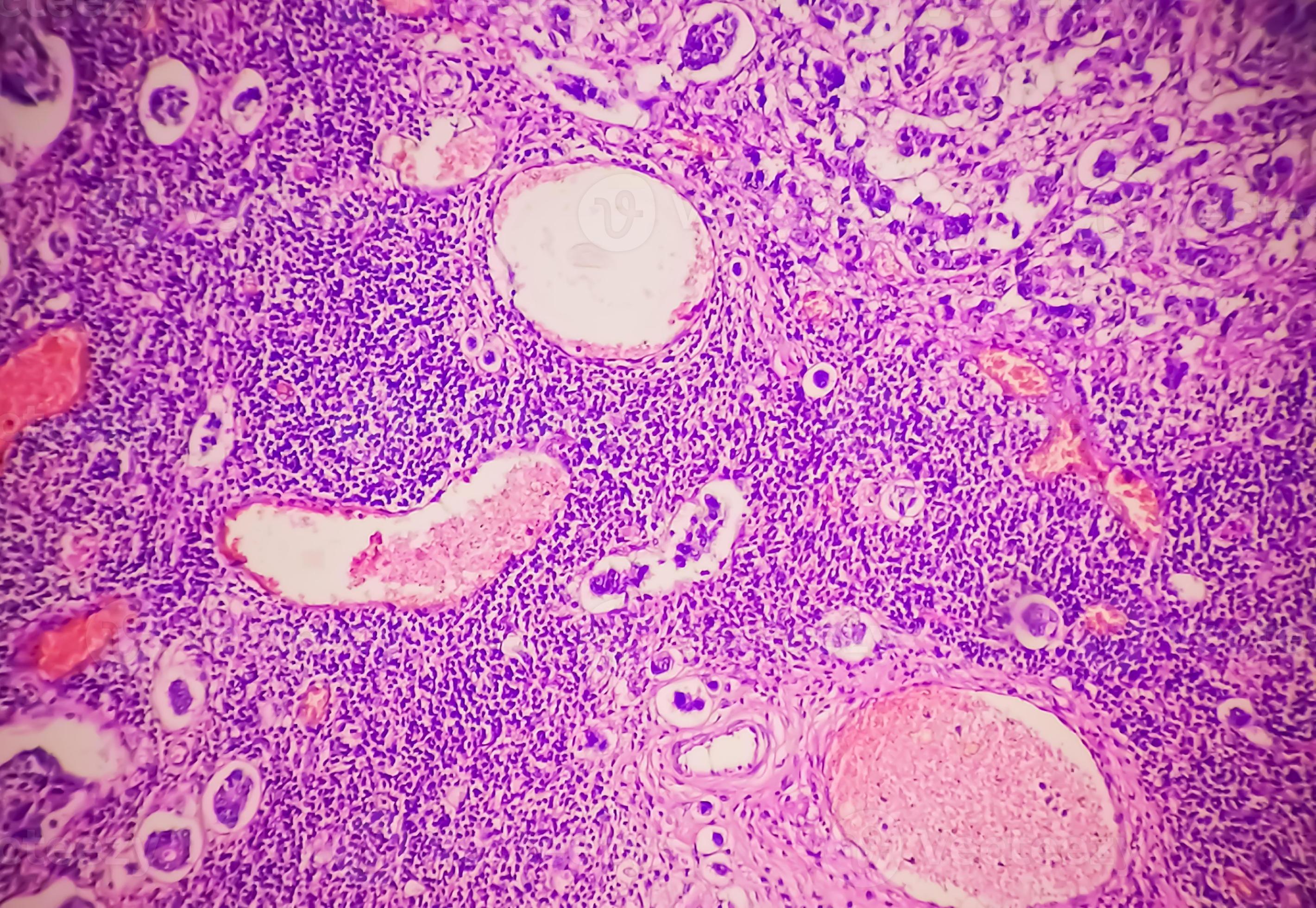 Low power photomicrograph of a breast core biopsy showing an invasive ... Low power photomicrograph of a breast core biopsy showing an invasive ...