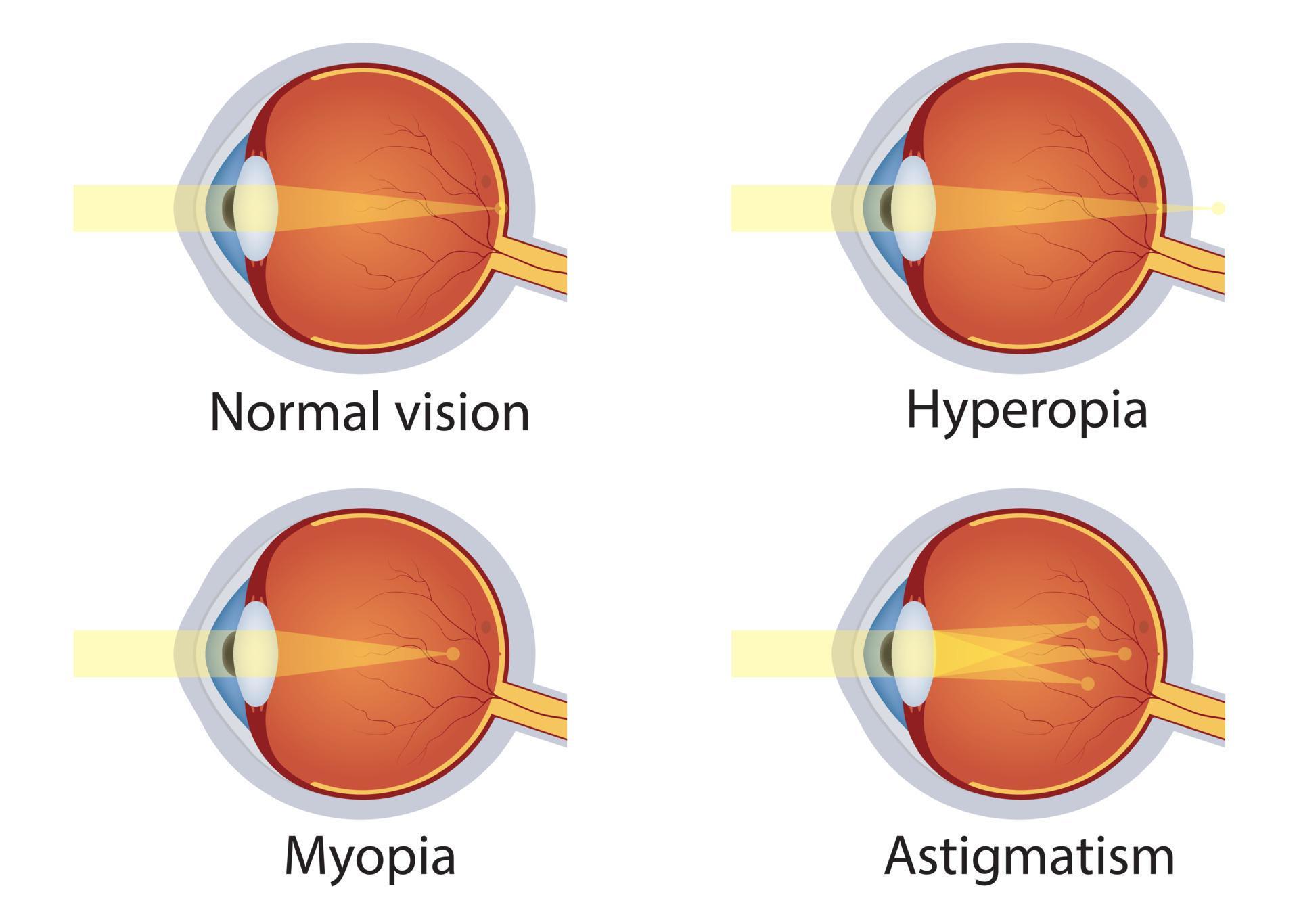 Vision disorders. Concept of eyes defect. Normal vision, hyperopia ... Vision disorders. Concept of eyes defect. Normal vision, hyperopia ...