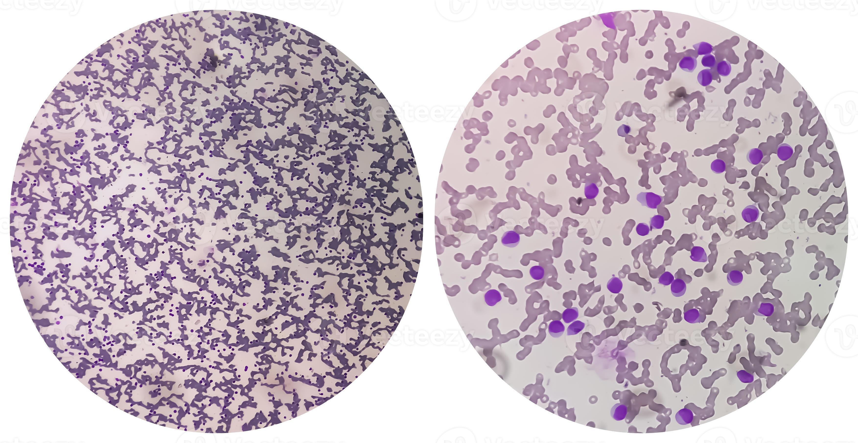 Collage Image Of Two Micrograph Show Auer Rods Seen In Acute Myeloid Leukemia Myeloblasts