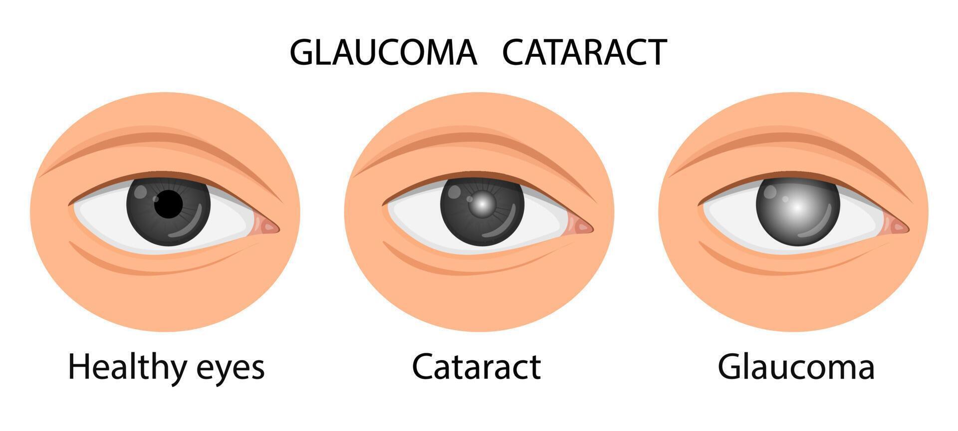 Ilustración De Un Ojo Sano Glaucoma Catarata 5860683 Vector En Vecteezy