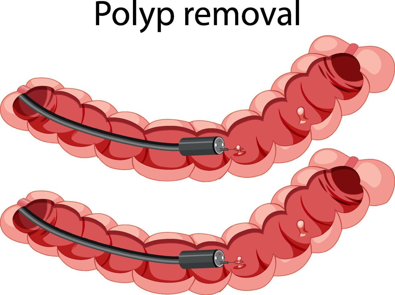 Diagram Showing Polyp Removal 6763852 Vector Art At Vecteezy