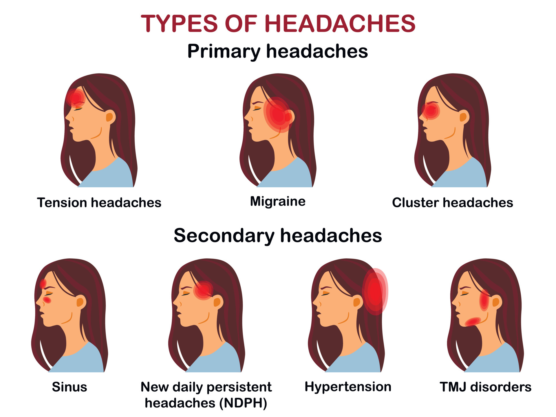 Types of headaches. Vector Infographic. 6891055 Vector Art at Vecteezy