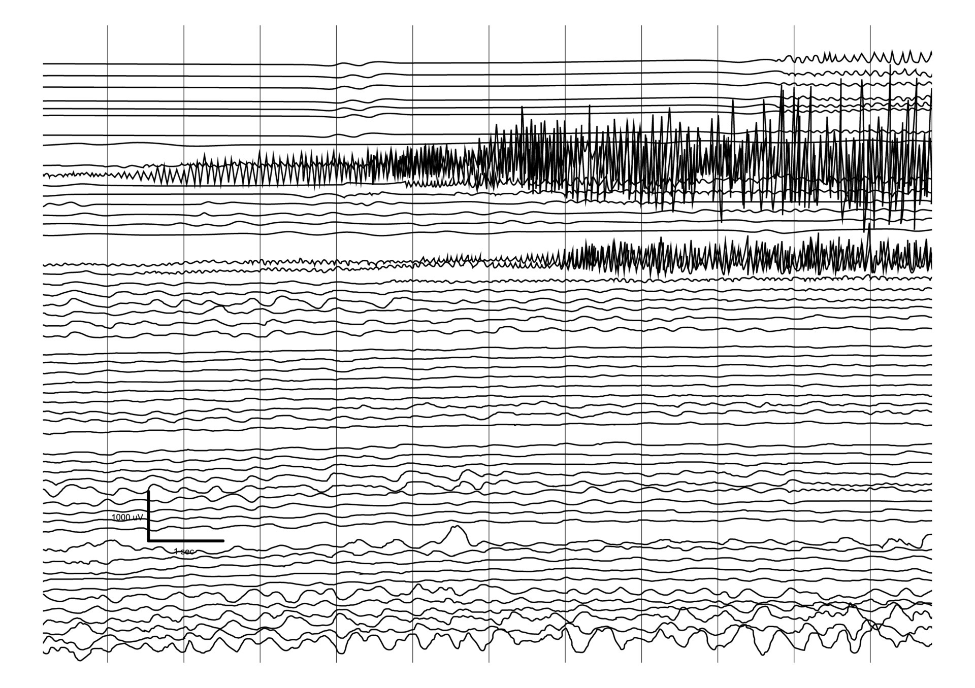 Vector Illustration of ictal EEG recording during seizure. 6948866 ... Vector Illustration of ictal EEG recording during seizure. 6948866 ...