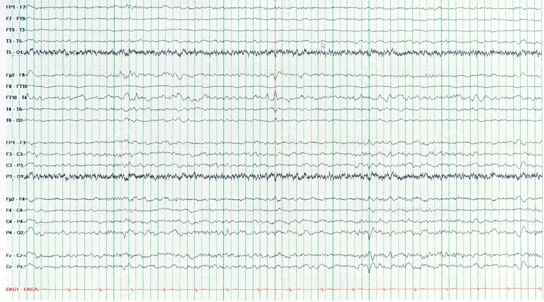 Photography of sharp wave during interictal EEG in epilepsy 7327430 ... Photography of sharp wave during interictal EEG in epilepsy 7327430 ...