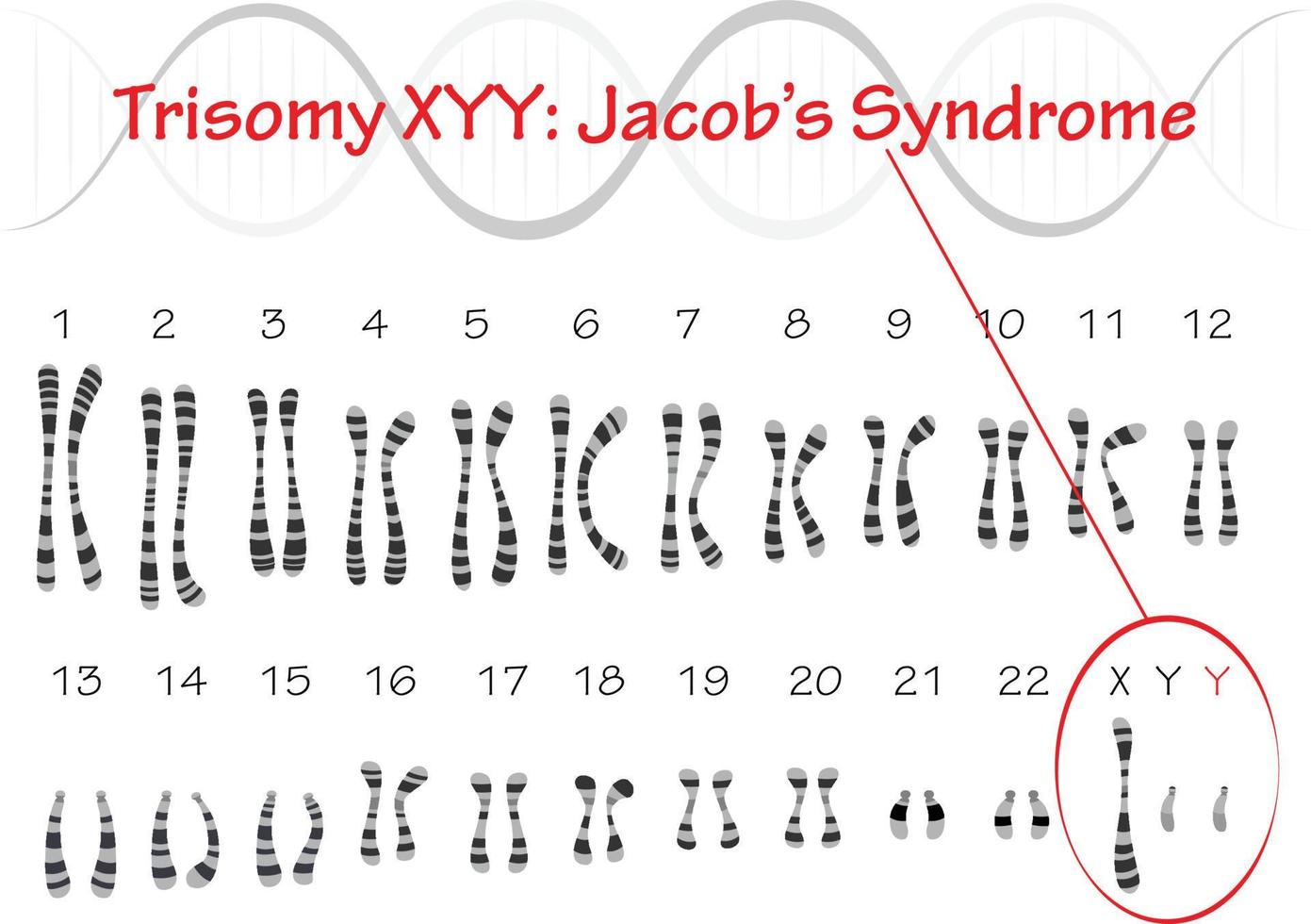 Trisomy Xyy Jacobs Syndrome 7818648 Vector Art At Vecteezy