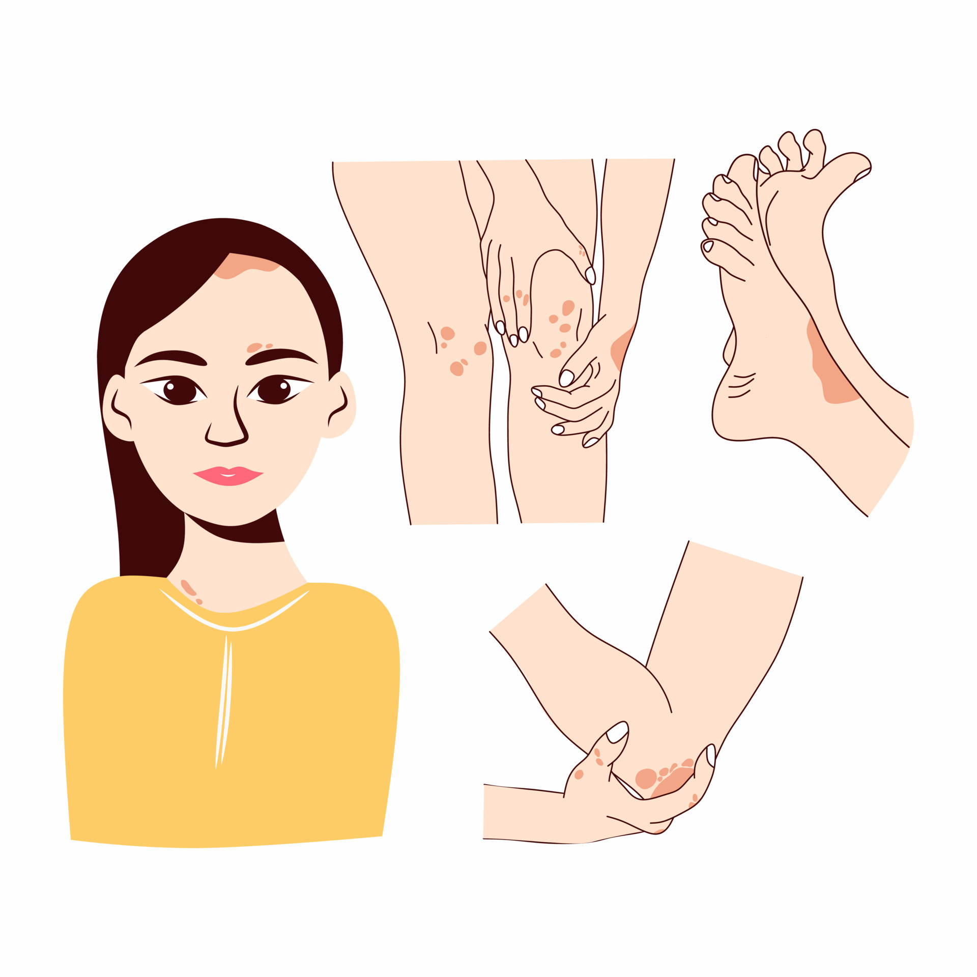 Young Woman Body Parts With Psoriasis Vector Illustration 7995508