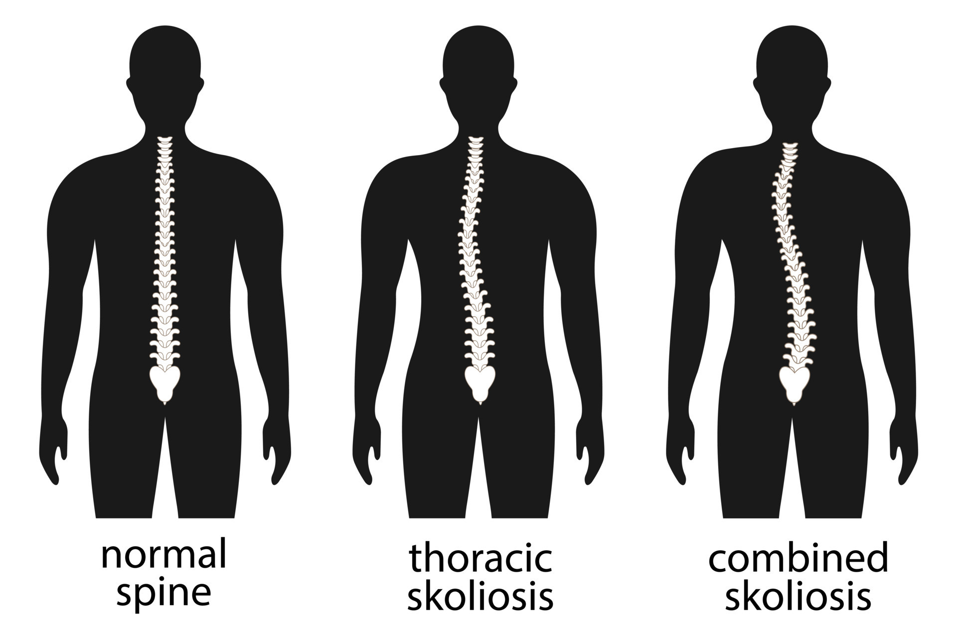 Vector Illustration Of Spinal Deformity Kyphosis Lordosis And Scoliosis Spine Infographic
