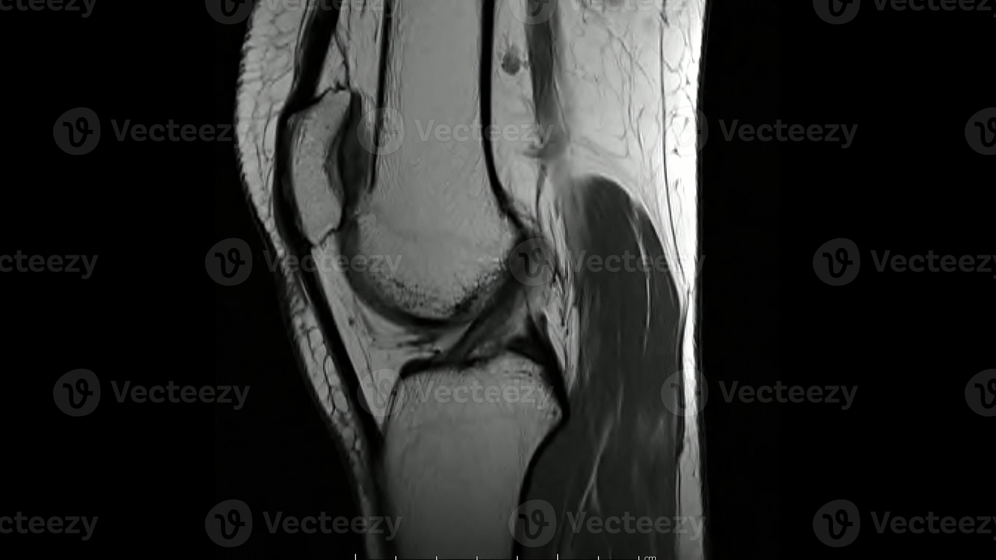 Knee Anatomy Mri