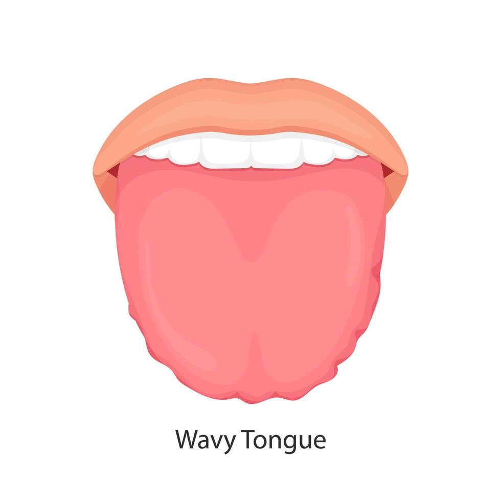 swollen enlarged white tongue with wavy ripple scalloped edges 8569562 ... swollen enlarged white tongue with wavy ripple scalloped edges 8569562 ...