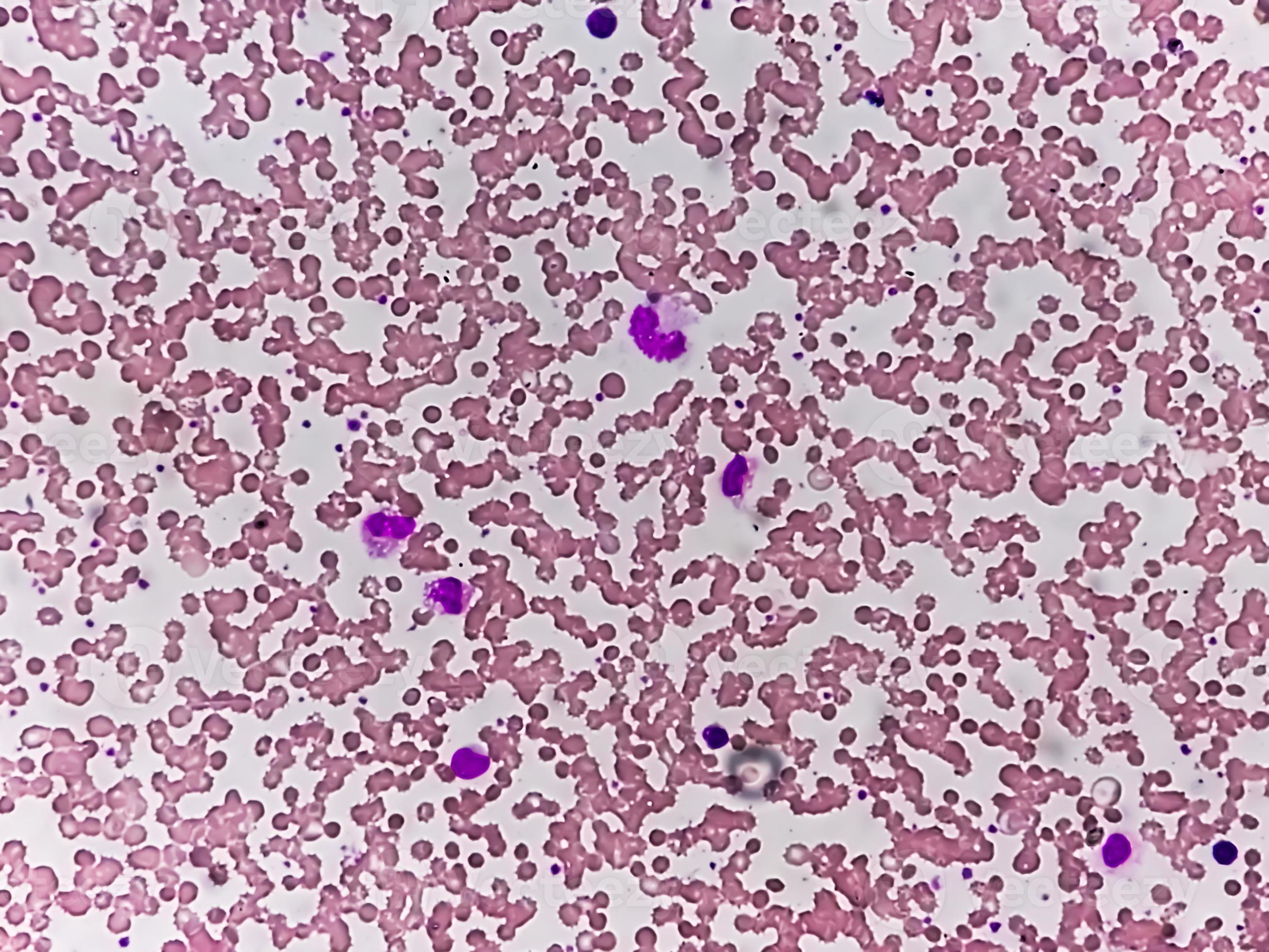 Iron Deficiency Anemia Under Microscope