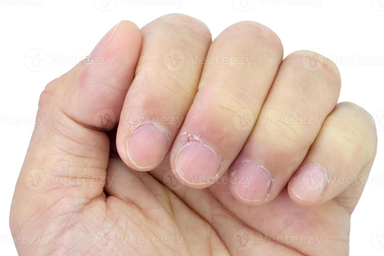 Close Up Of Fingers And Nails With Dry Skin Torn And Flaking Off