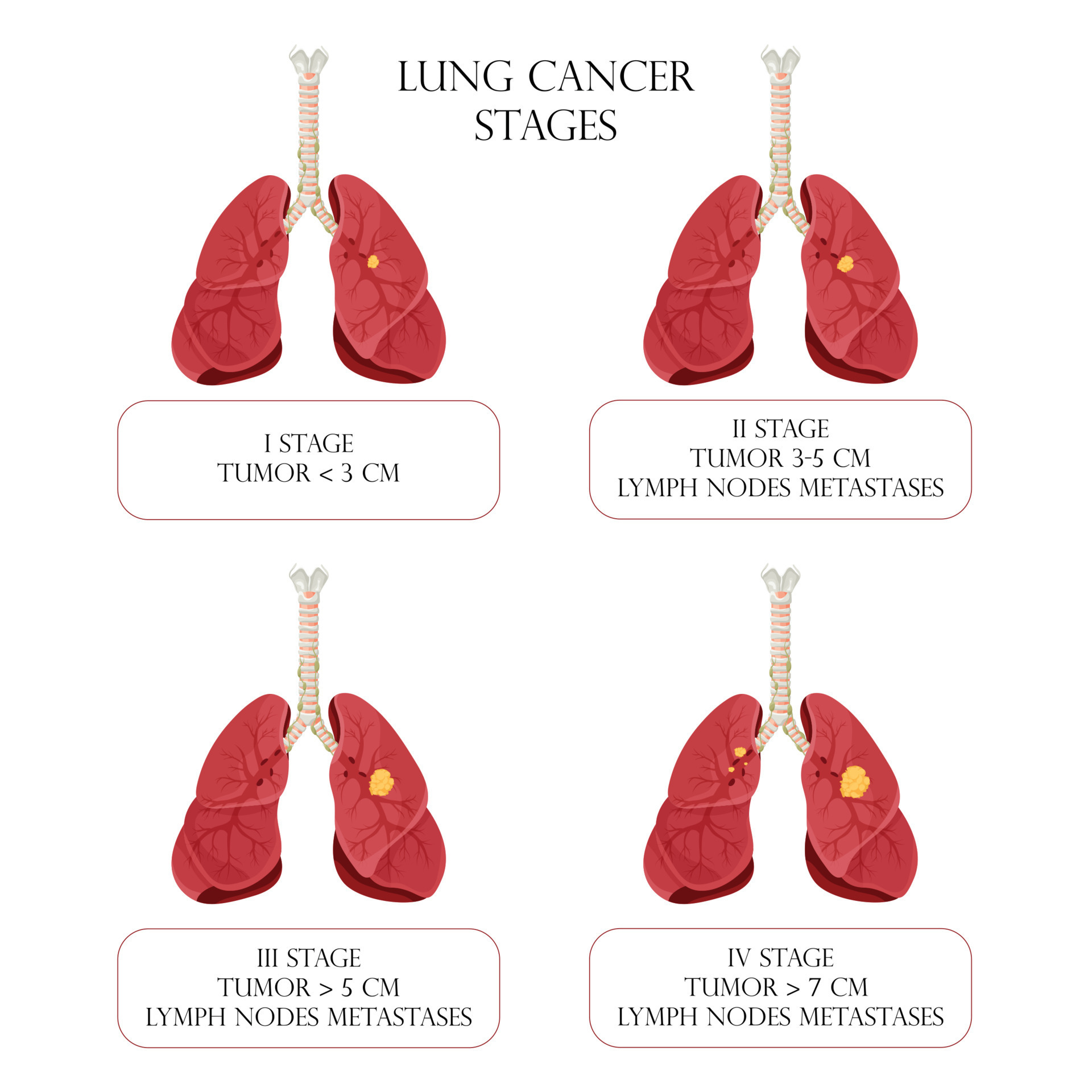 Lung Cancer Stages Concept Diseases Human Internal Organs Cartoon
