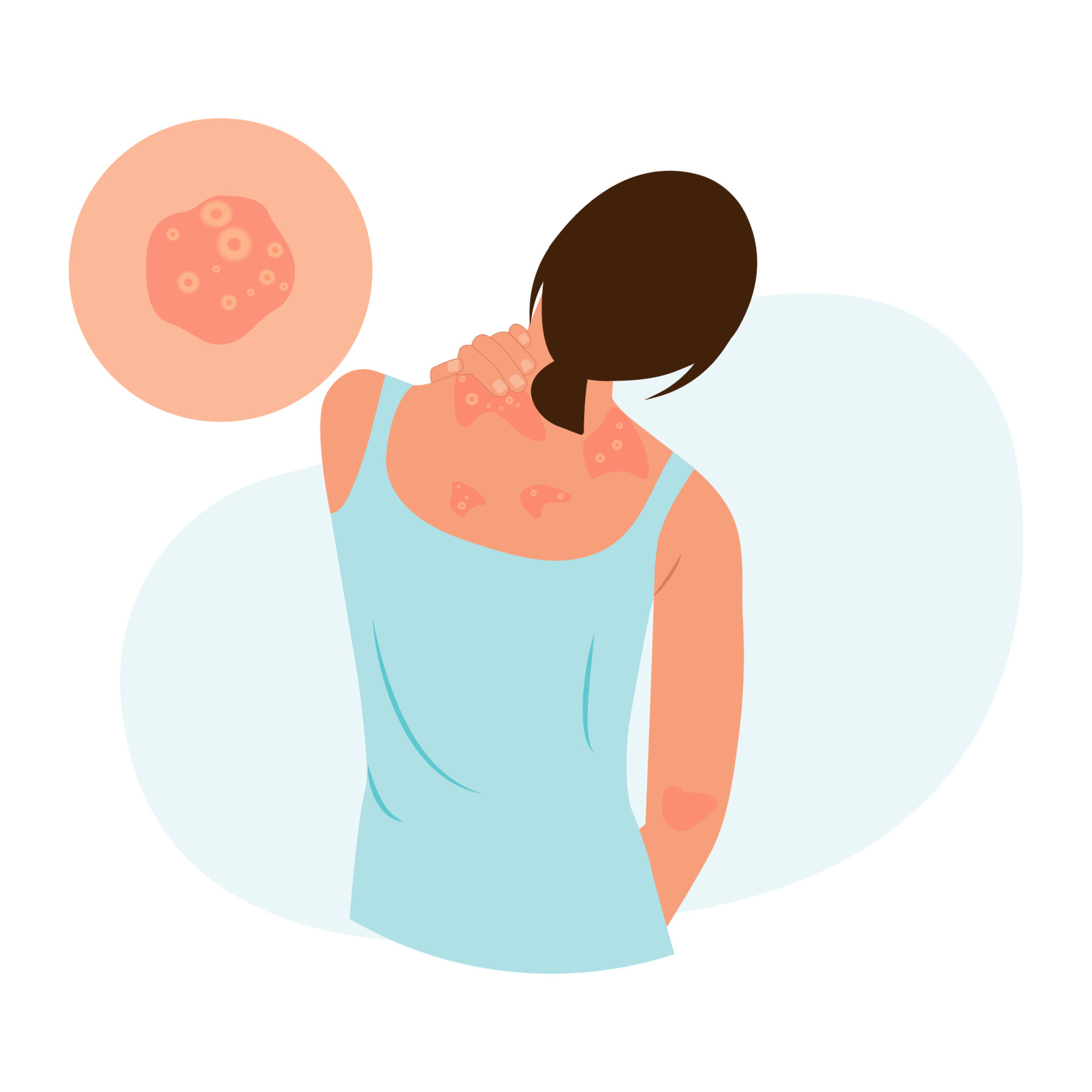 The woman is scratching her back. Pustular psoriasis.Allergic itching ... The woman is scratching her back. Pustular psoriasis.Allergic itching ...