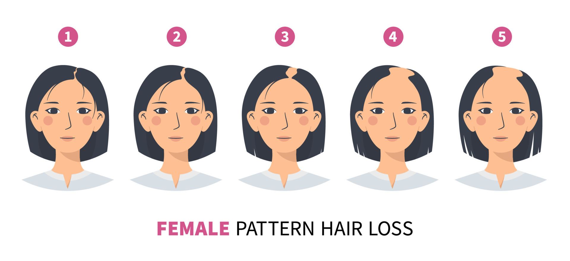 Hair loss stages, androgenetic alopecia female pattern FPHL. Steps of baldness vector ...