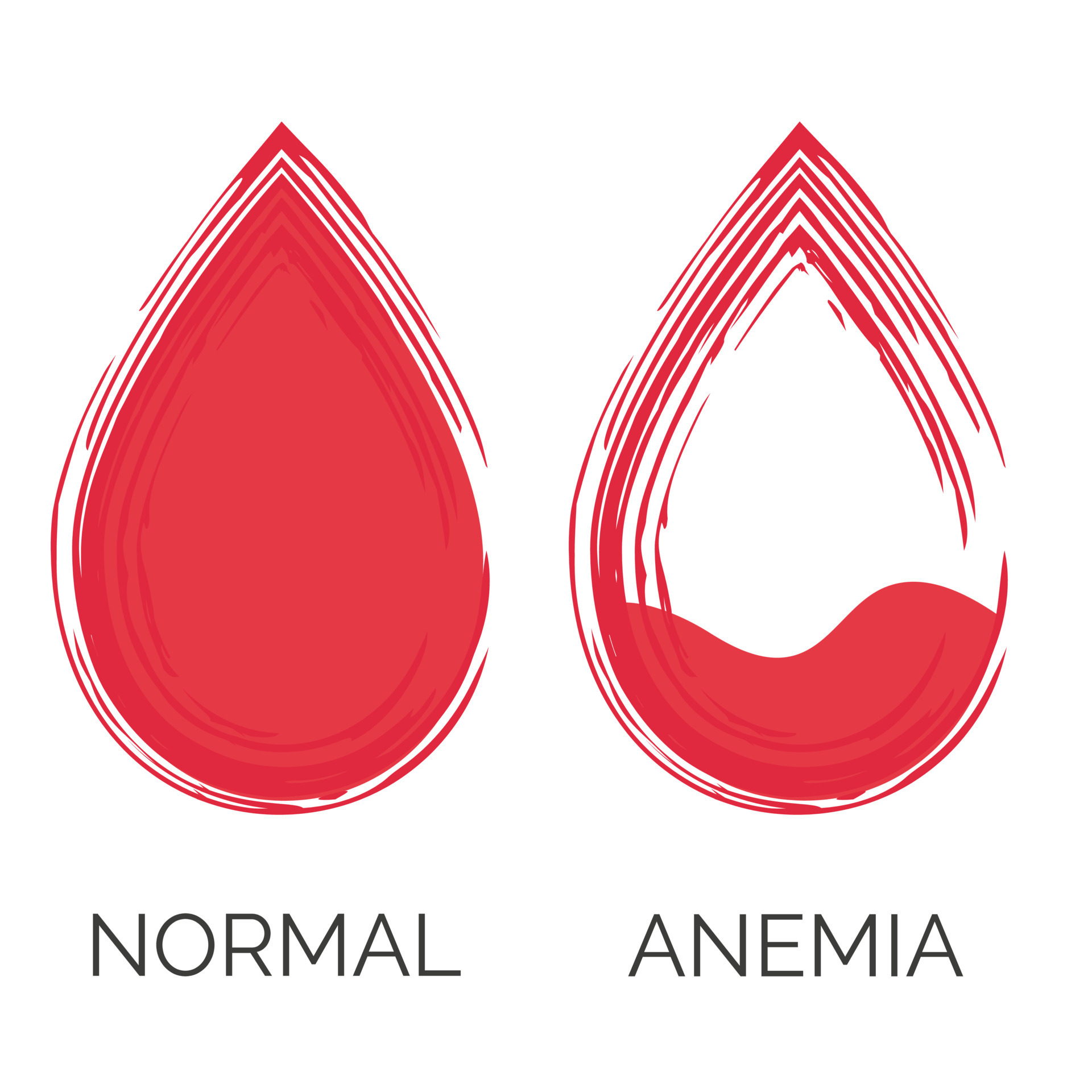 Normal And Anemic Drop Of Blood Lack Of Red Cells Anemia Isolated On normal-and-anemic-drop-of-blood-lack-of-red-cells-anemia-isolated-on