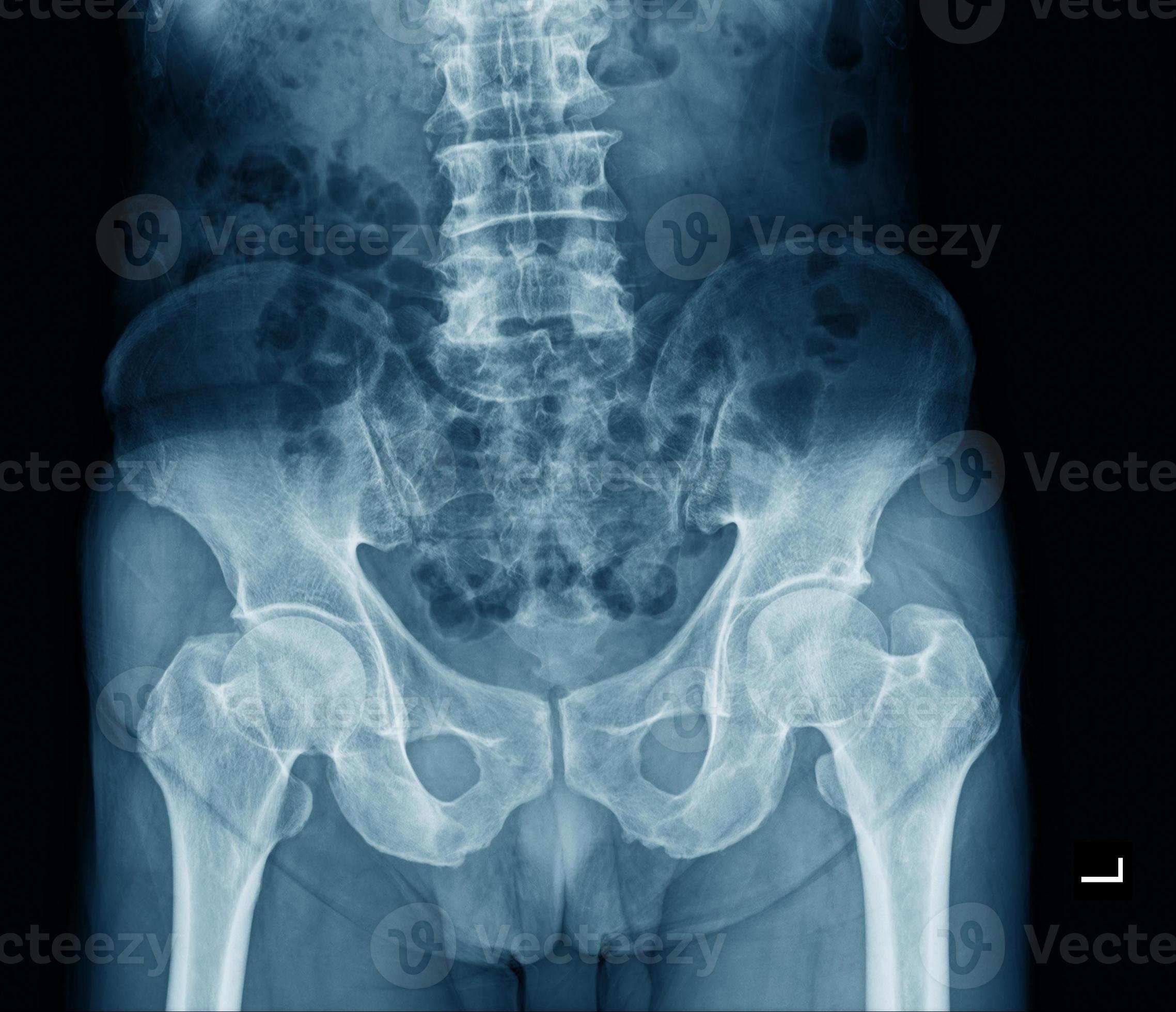 human pelvic bone x ray 10764688 Stock Photo at Vecteezy