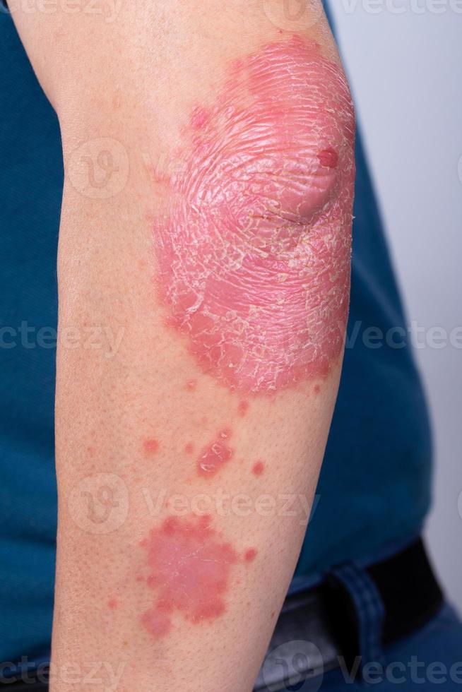 Unrecognizable Man Feel Bad On Skin Disease Called Psoriasis Large Red Inflamed Rash On