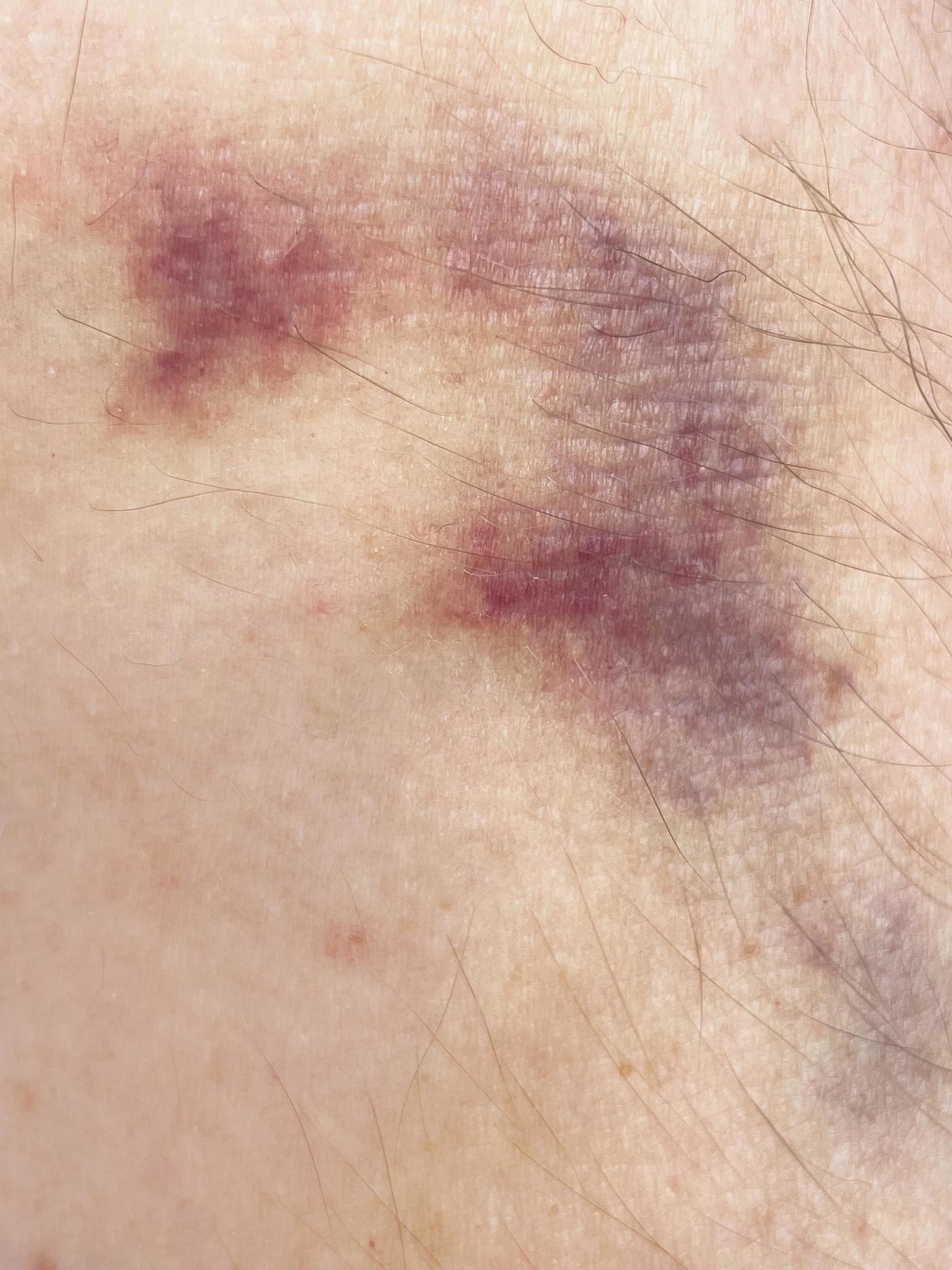 Moretón O Contusión De Primer Plano O Hematoma En La Piel Mal Peluda 11313042 Foto De Stock En