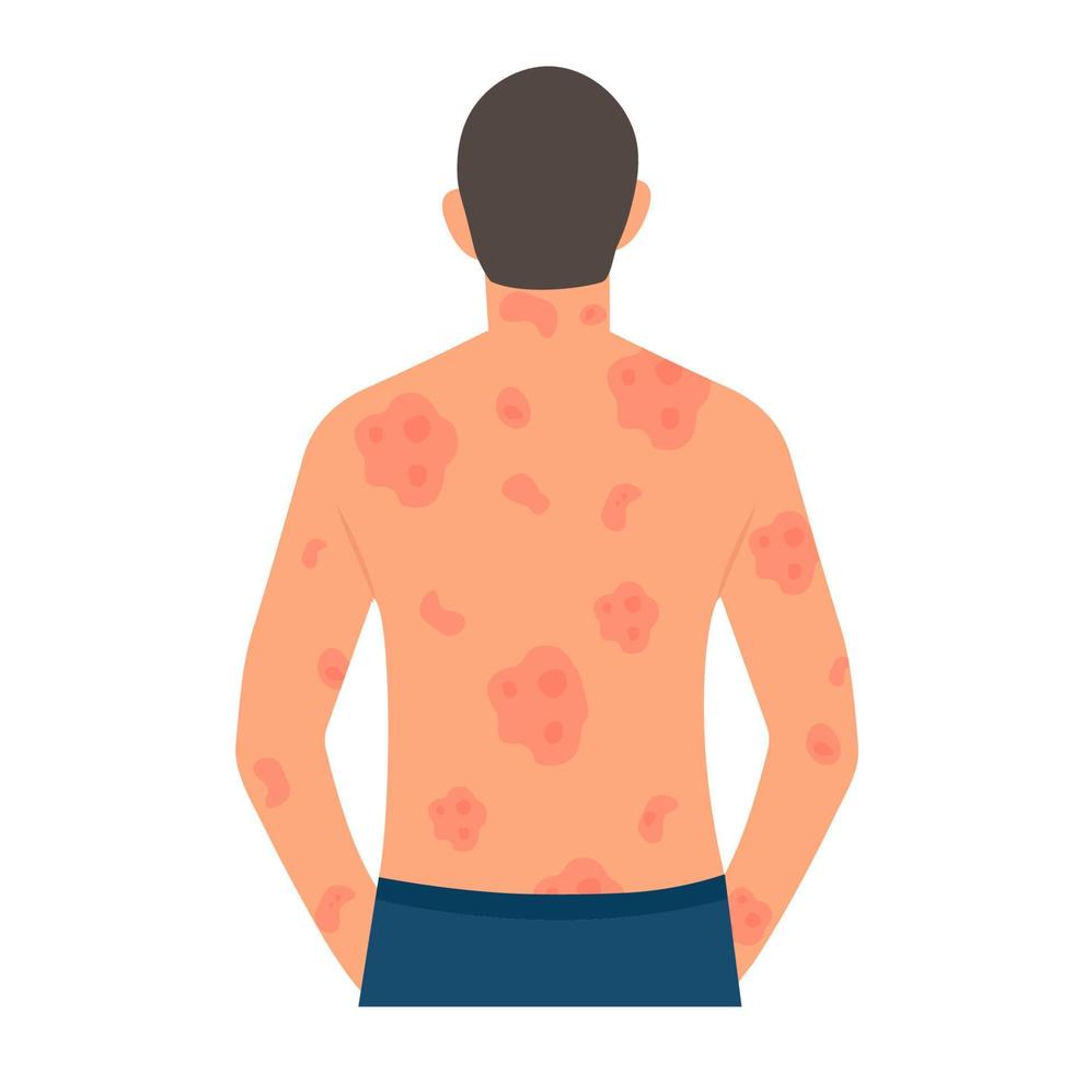 Dermatological skin disease, psoriasis.Allergic itching, skin ... Dermatological skin disease, psoriasis.Allergic itching, skin ...