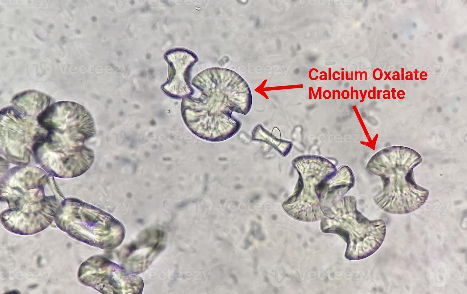 Imagen Microscópica Que Muestra Monohidrato De Oxalato De Calcio Del Sedimento De Orina Uti