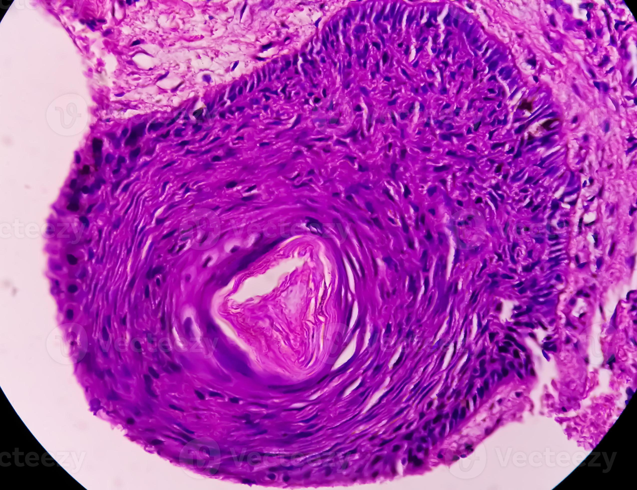 Skin Biopsy Suggestive Of Basal Cell Carcinoma The Most Common Type Of Skin Cancer 12601154