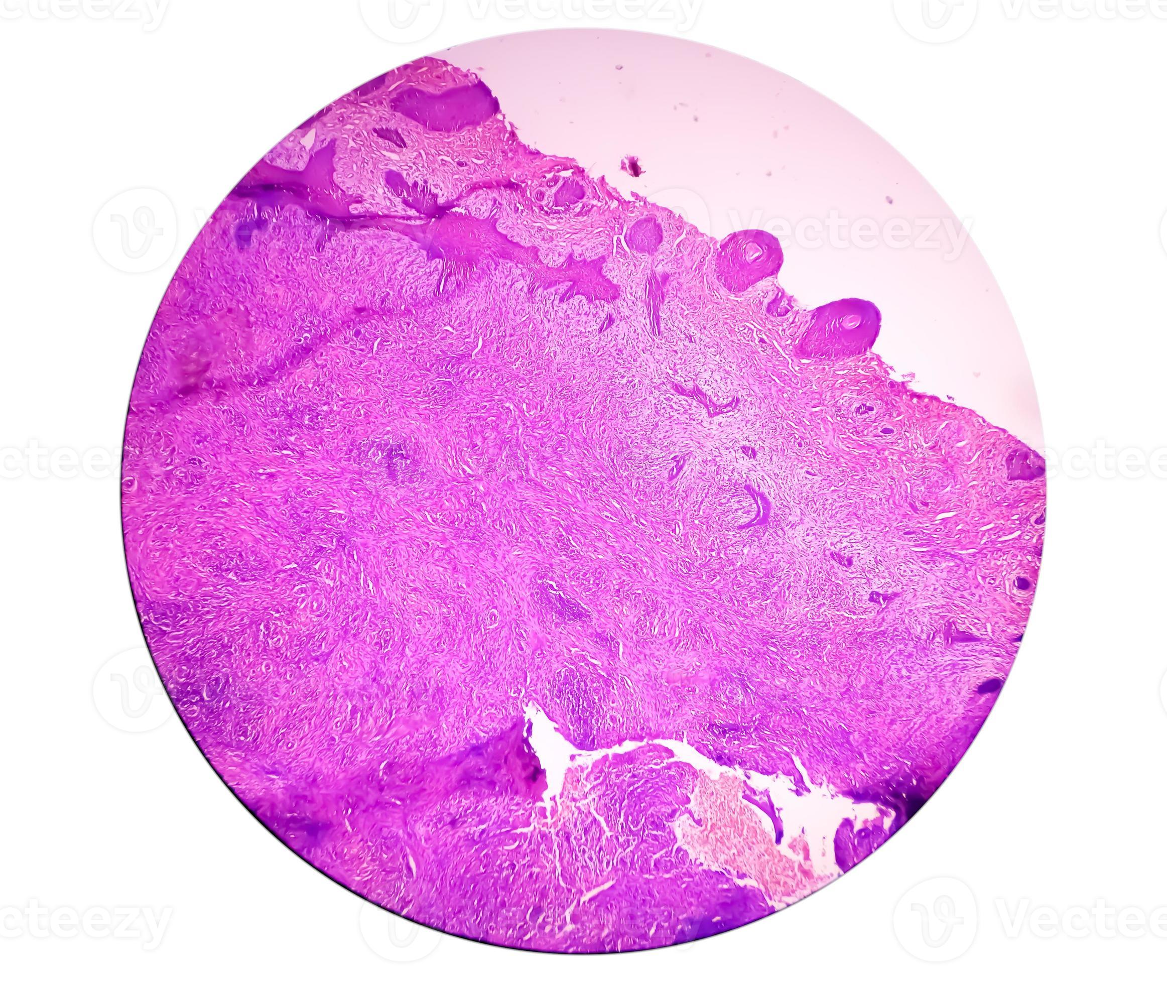 Biopsia De Piel Sugestiva De Carcinoma De Células Basales El Tipo Más