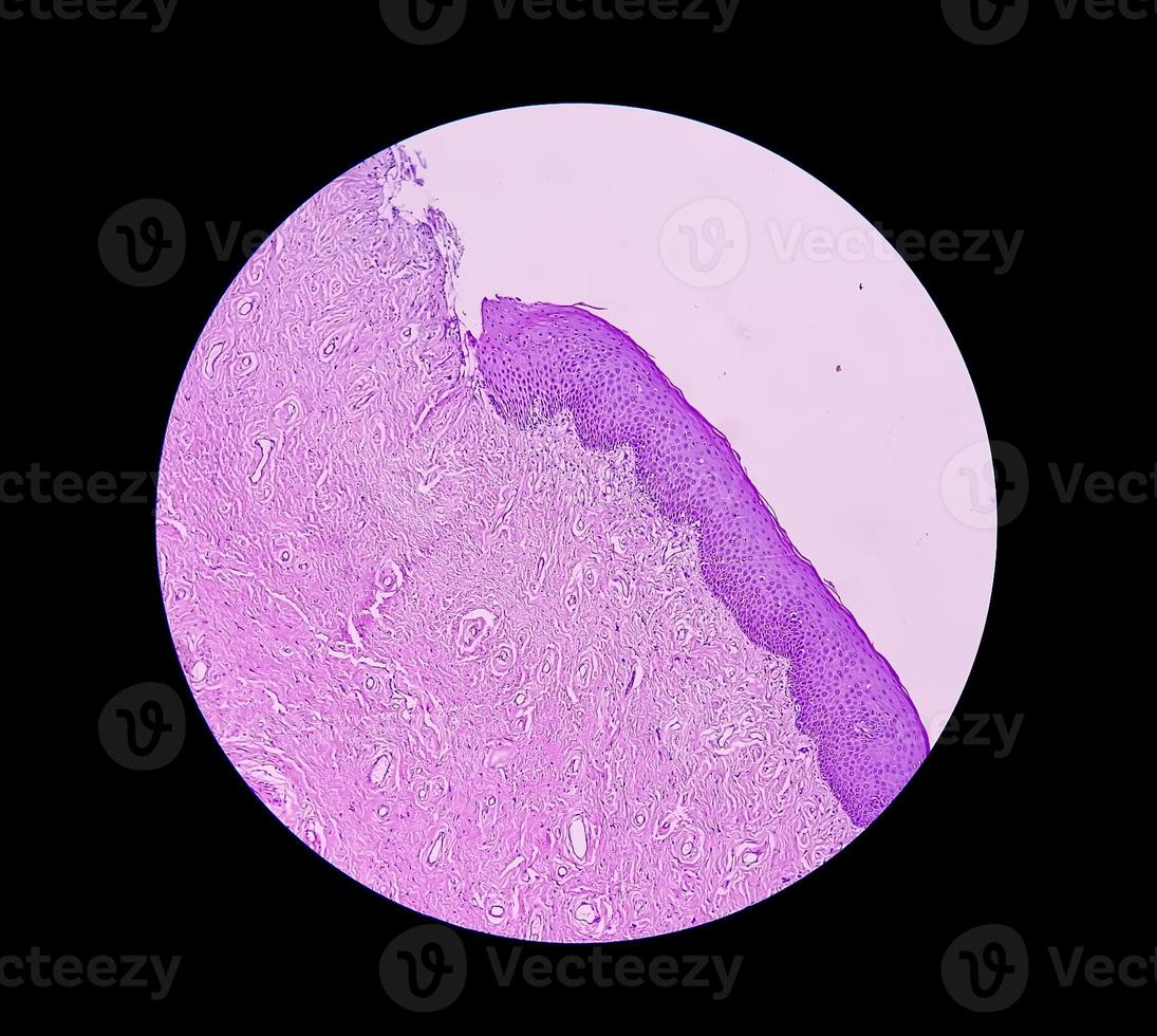 Biopsia Histológica De Pared Escrotal Bajo Microscopía Que Muestra