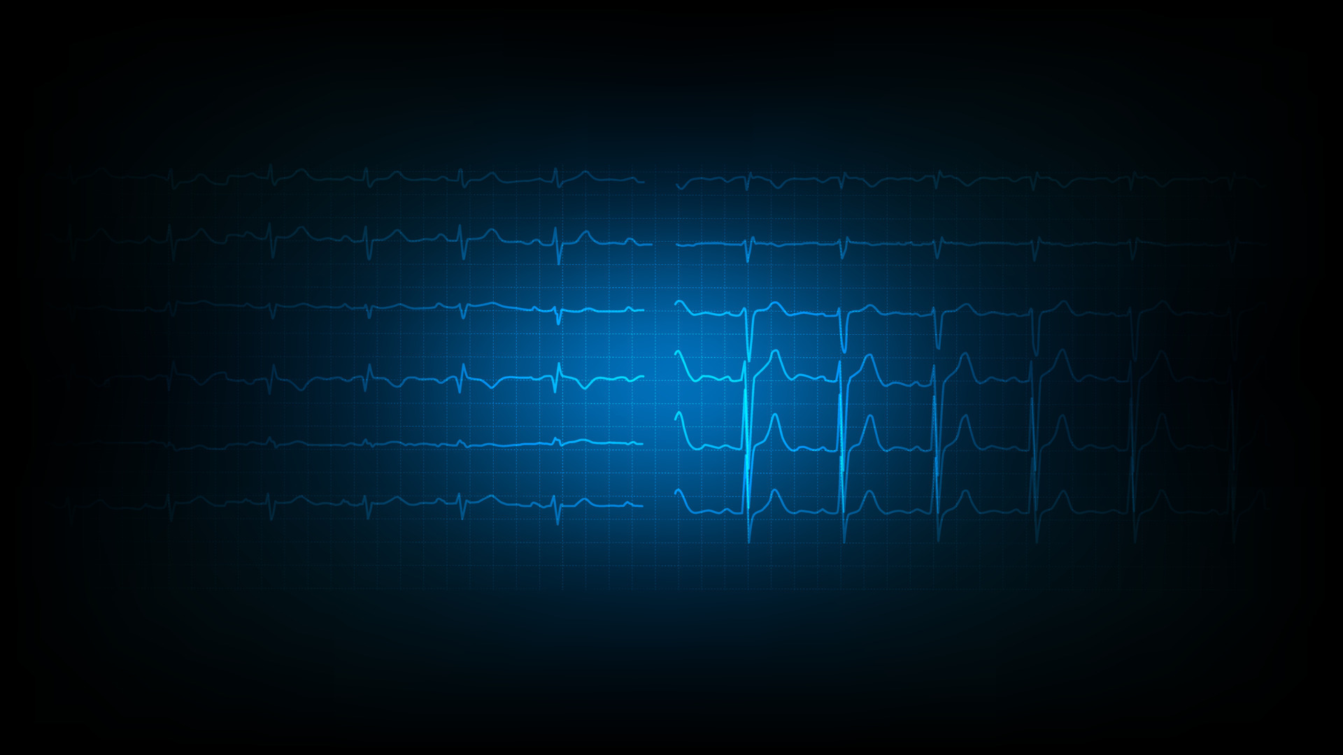 Ilustración De Ondas Cardíacas O Electrocardiografía En El Monitor De
