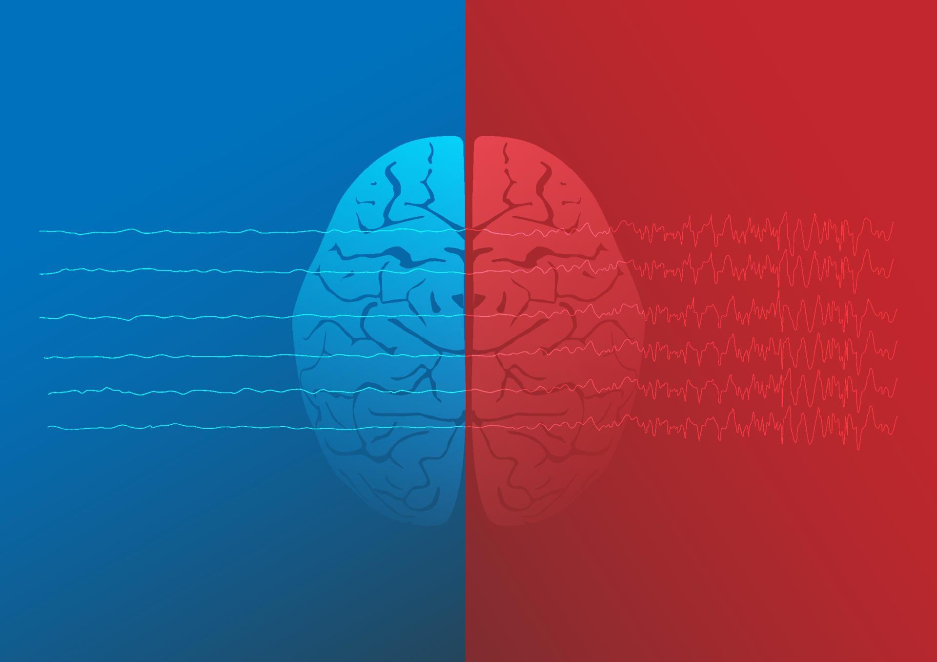 Illustration Of Human Normal Brain And Epileptic Brain Brain Waves Of Focal Seizure 12876620