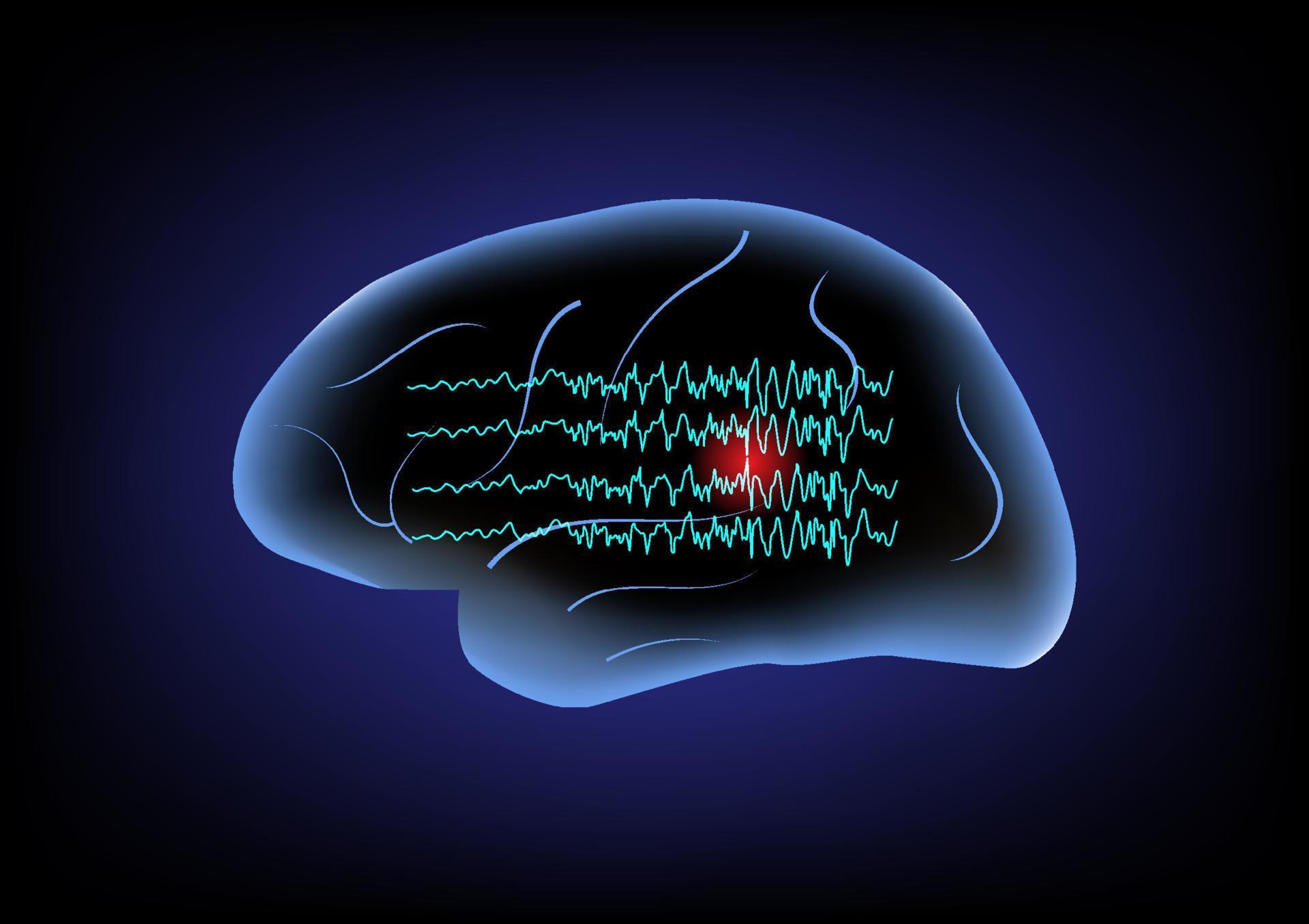 Abnormal Brain Waves And Human Brain Concept Of Focal Seizure 13179468 Vector Art At Vecteezy