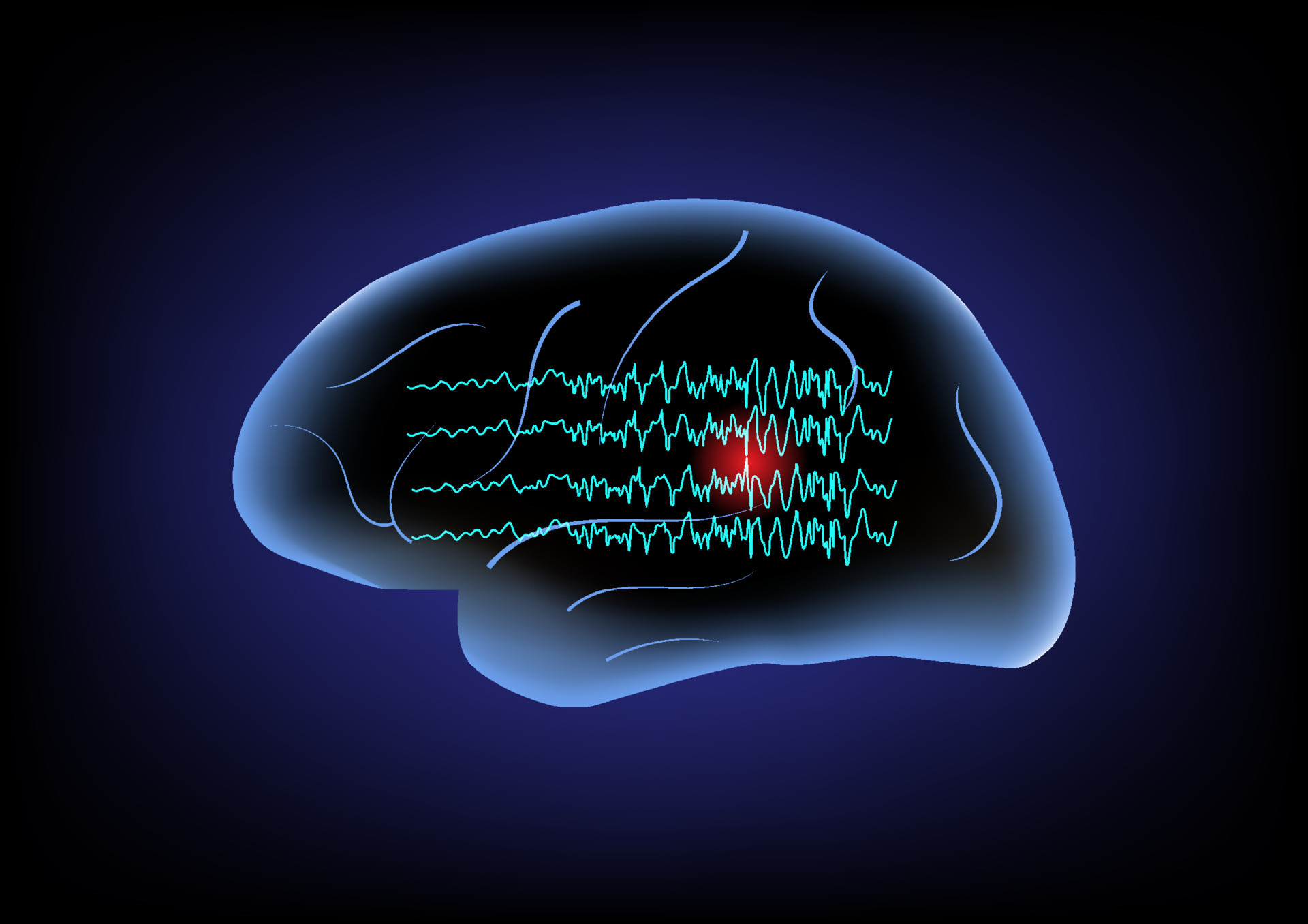 Abnormal brain waves and human brain. Concept of focal seizure ...