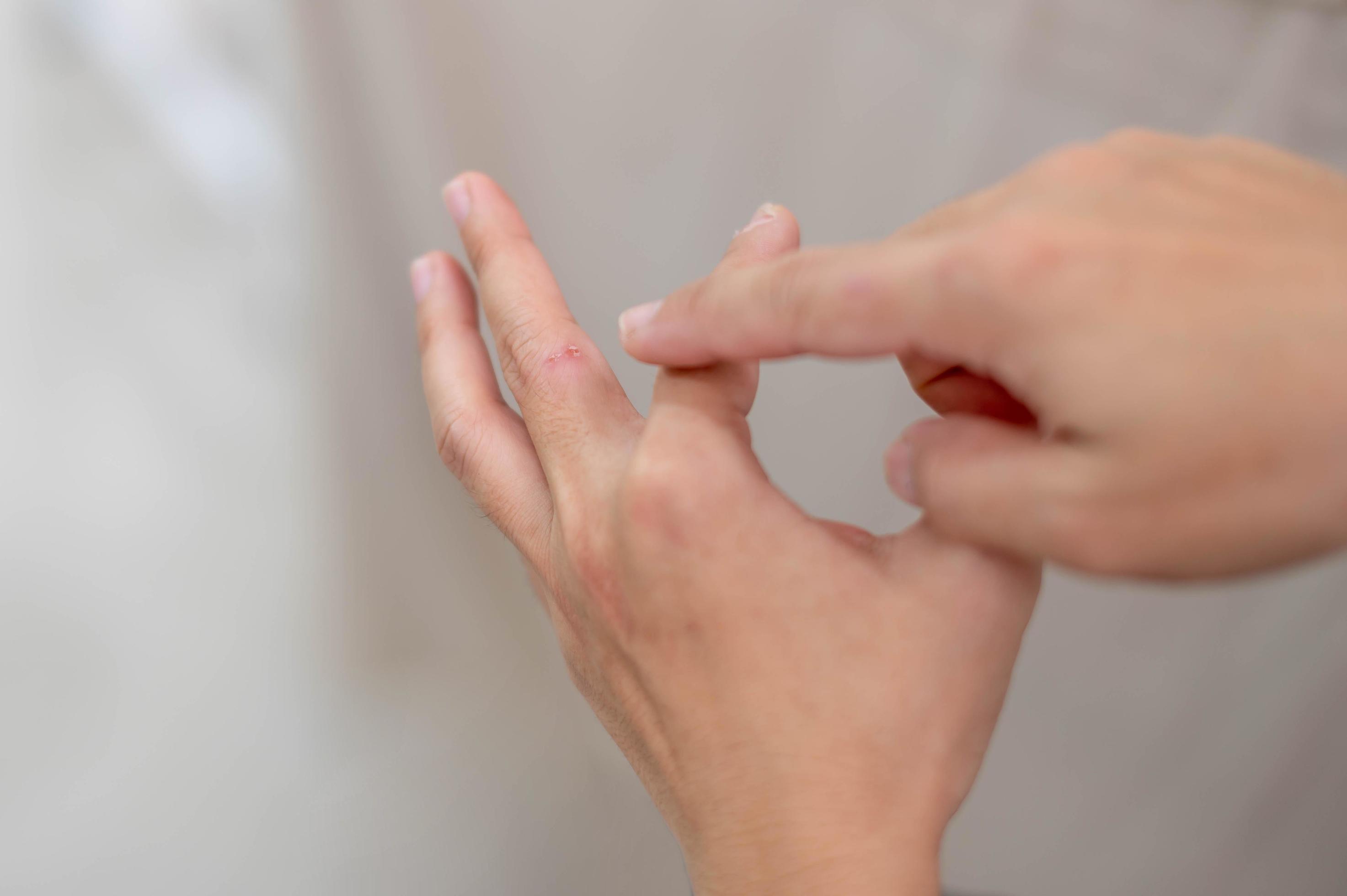 Female Hand Pointing To Dry Cracked Skin On Cuticles Skin Is Torn And
