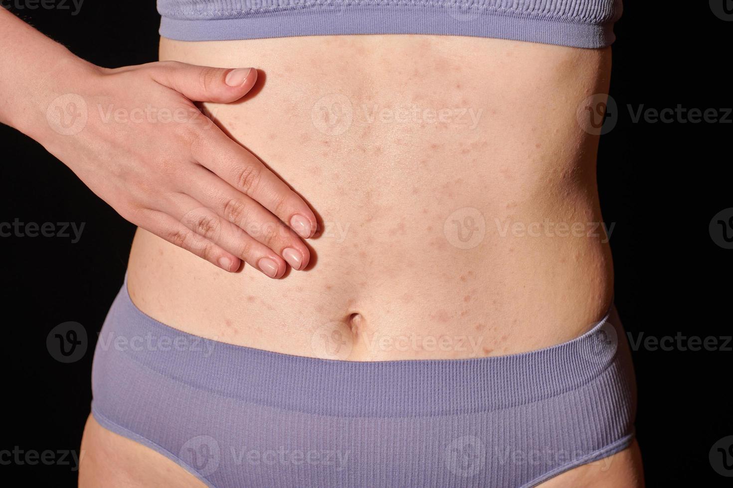 Red Allergic Rash On Belly Skin Atopic Dermatitis Eczema Inflammation Woman Applying