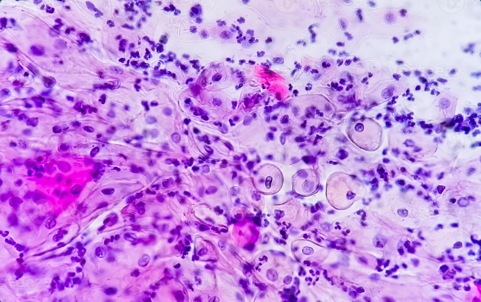 Paps Smear Microscopic Examination Of Pap Smear Showing Inflammatory Smear With Early Atrophic