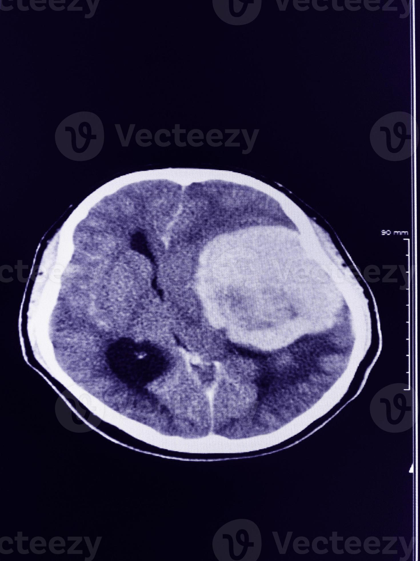Ct Brain Diameter Hyperdensity Mass With Lobulated Surface At Extra Axial Lateral To Lt Frontal