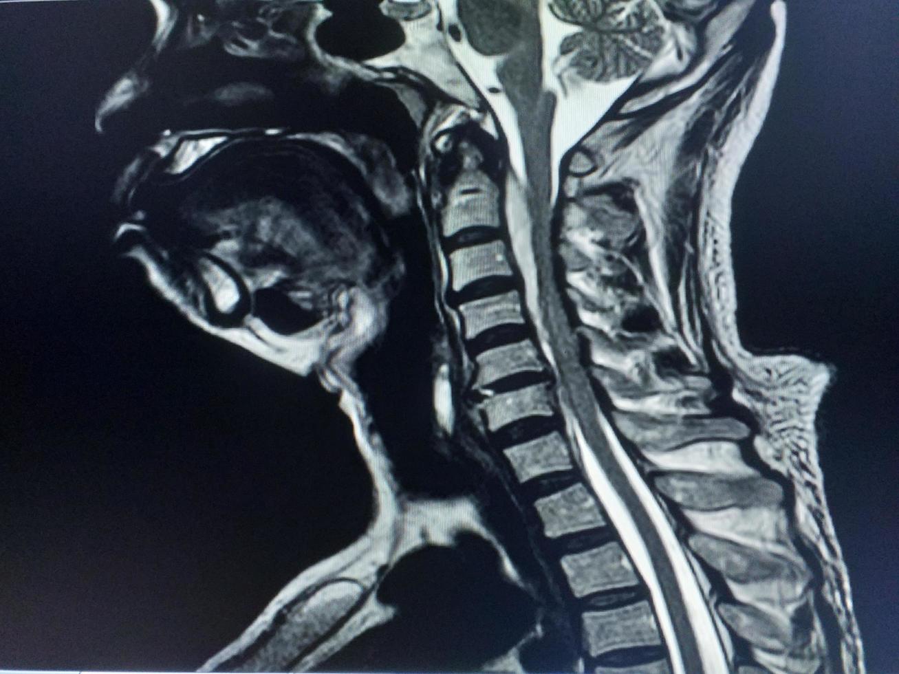 Resonancia Magnética De La Columna Cervical Muestra Compresión Moderada