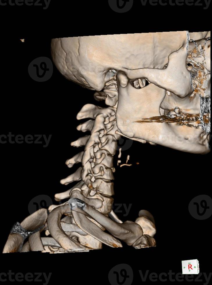 CT Scan cervical spine 3 D render . 15763217 Stock Photo at Vecteezy CT Scan cervical spine 3 D render . 15763217 Stock Photo at Vecteezy