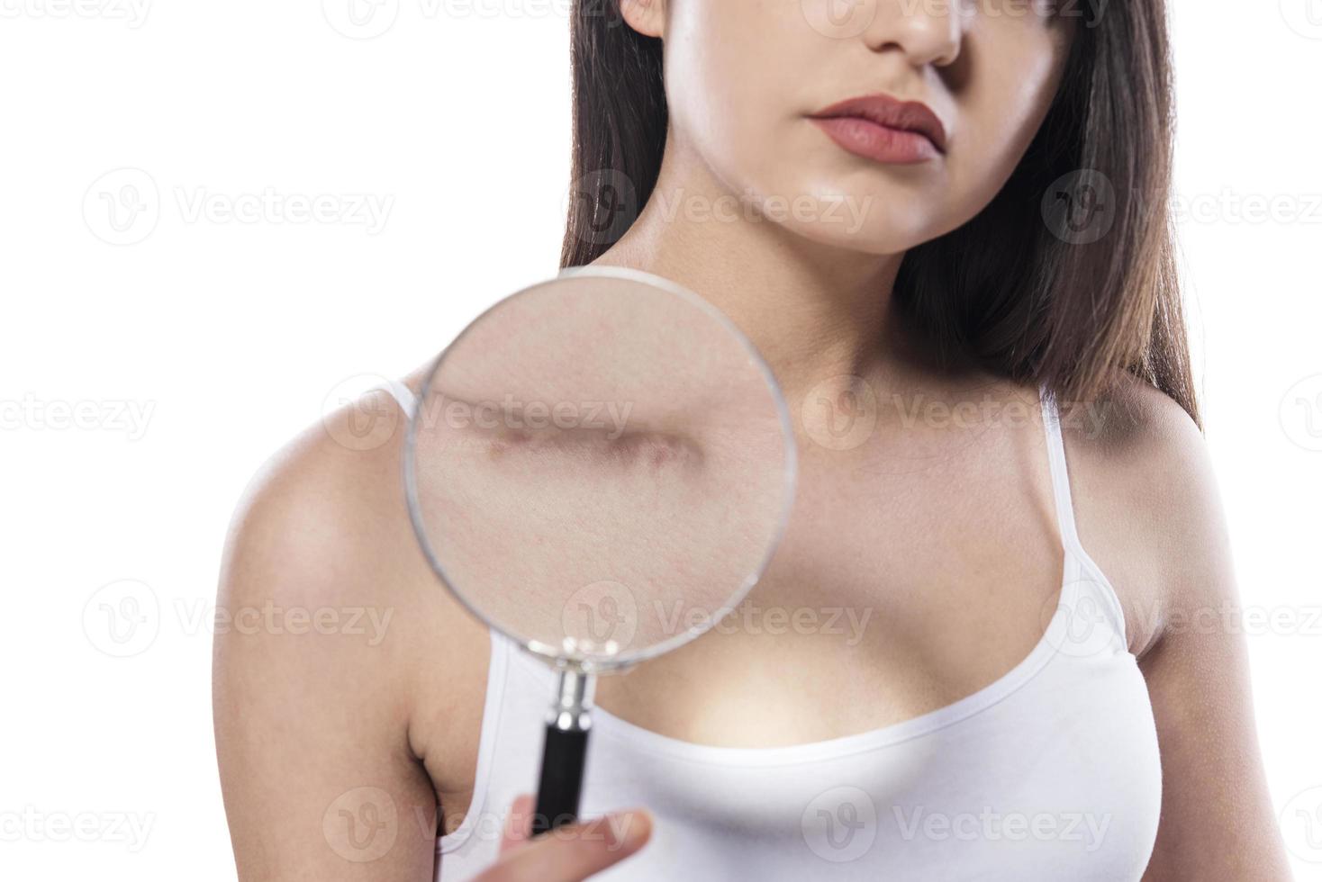 woman showing surgery scar. Scars removal concept, close up, selective focus 15977855 Stock ...