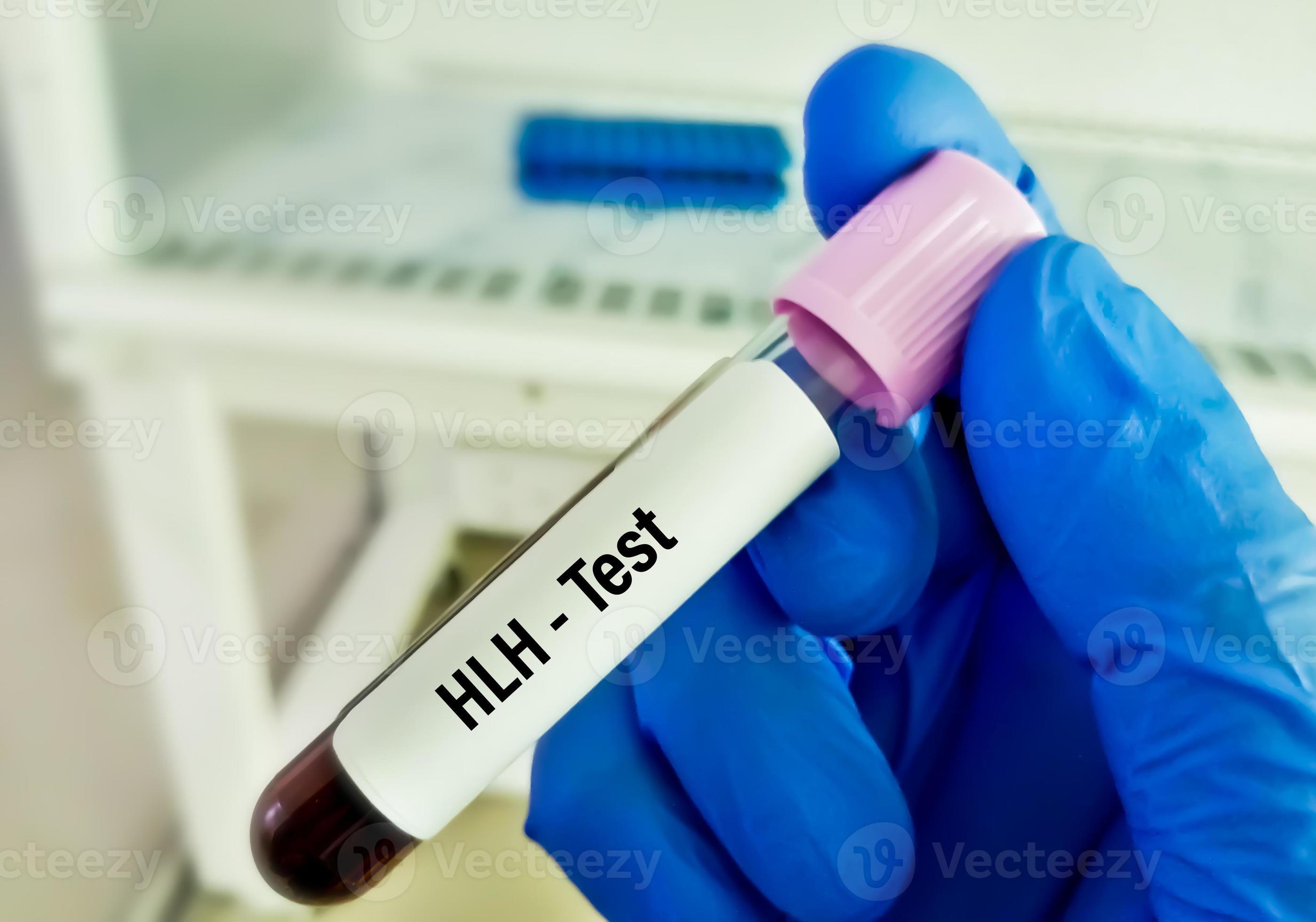 Blood sample for HLH or Hemophagocytic Lymphohistiocytosis, a rare ...