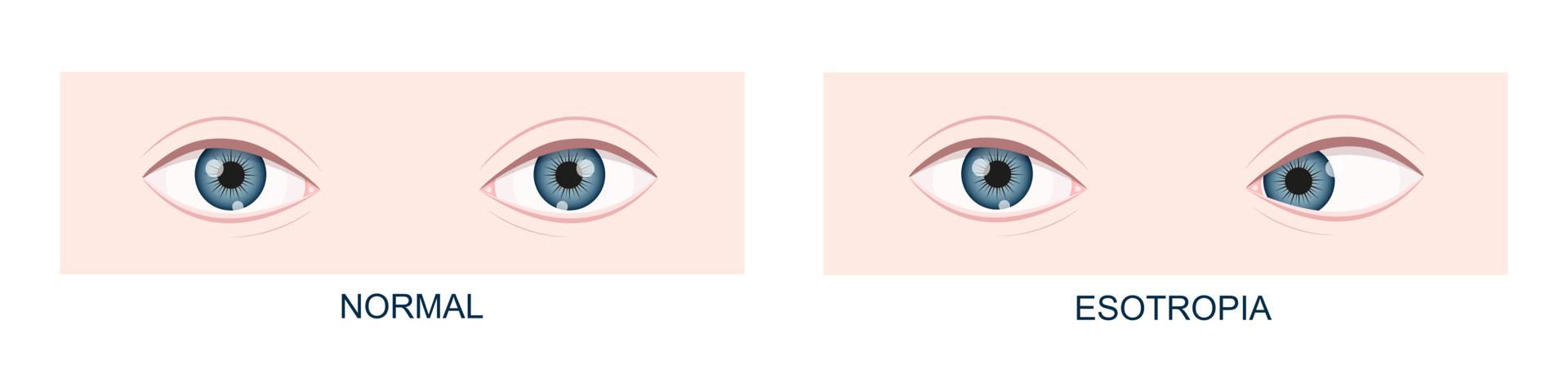 Esotropia Horizontal Strabismus Before And After Surgery Eye Misalignment Cross Eyed