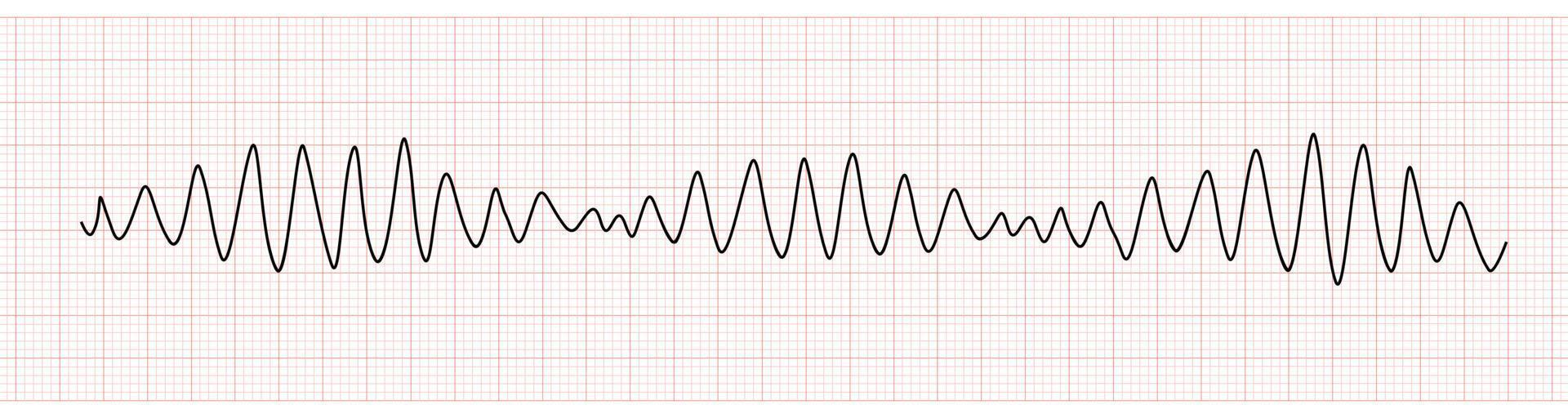 EKG Monitor Showing Polymorphic Ventricular tachycardia or VT Torsades ...