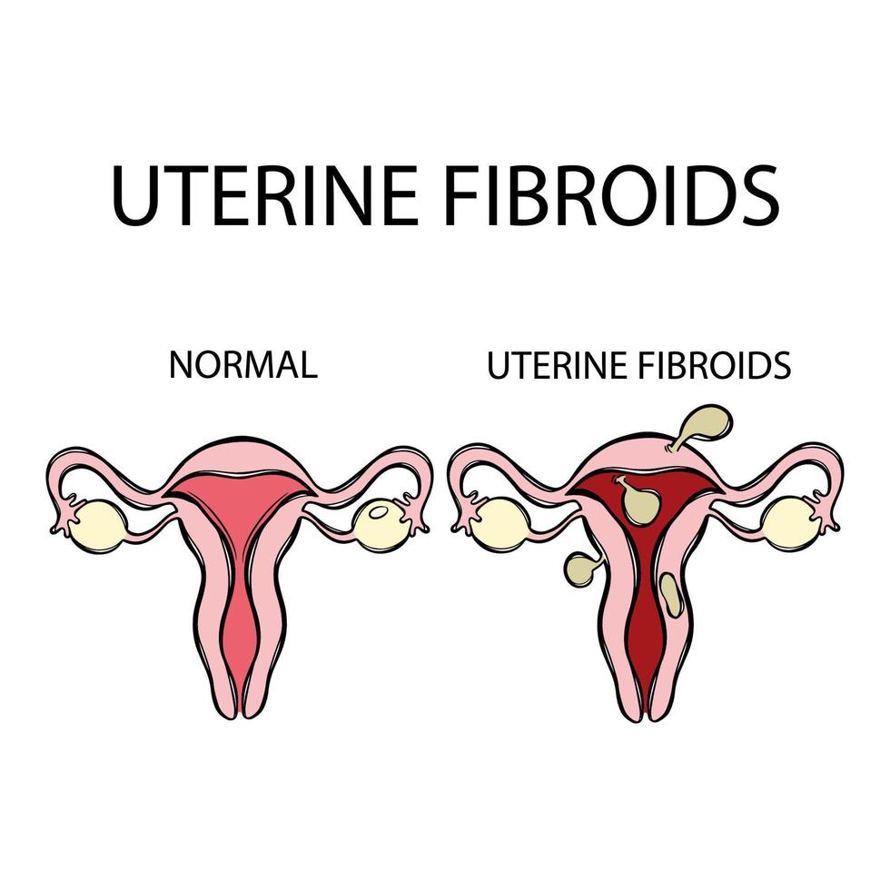 Uterine Fibroids Vs Normal Female Reproductive Education Set 20433028