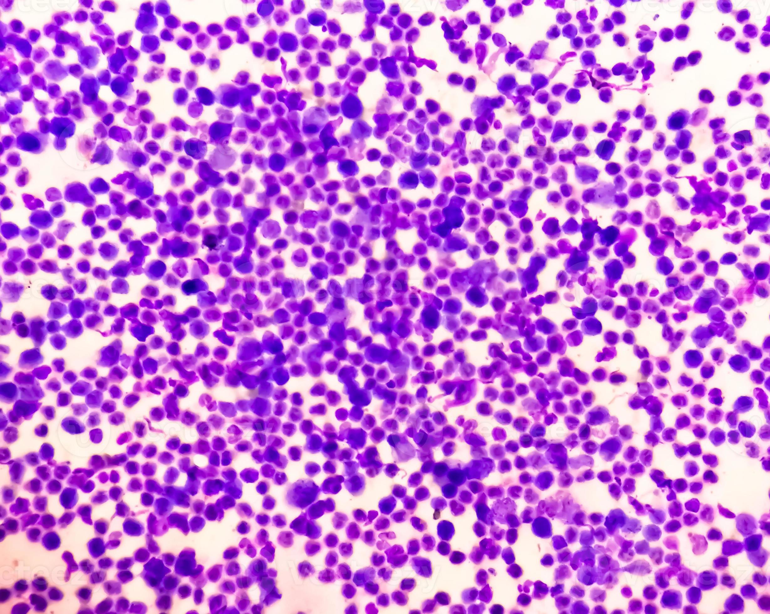 Synovial Fluid Cytology Plenty Wbc Microscopic Examination Of Synovial Fluid To Diagnose